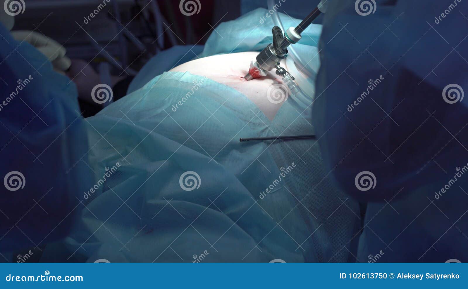 Operation Using Laparoscopic Equipment. Surgeons Team. Hospital. Stock ...