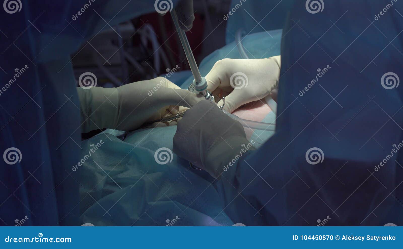 Operation Using Laparoscopic Equipment. Surgeons Team. Hospital. Stock ...