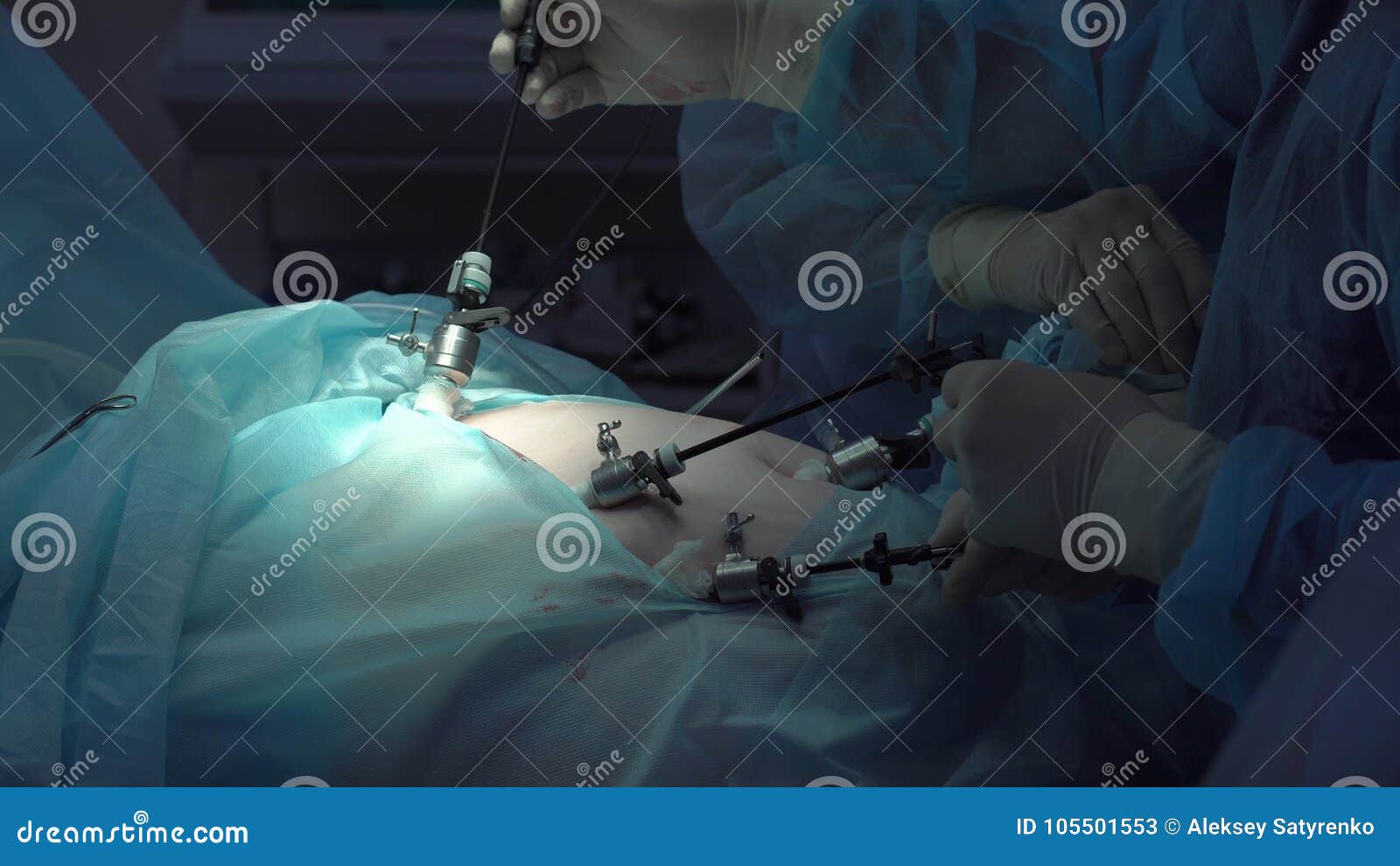 Operation Using Laparoscopic Equipment. Surgeons Team. Hospital. Stock ...