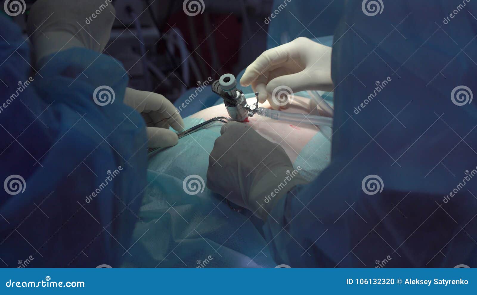 Operation Using Laparoscopic Equipment. Surgeons Team. Hospital. Stock ...