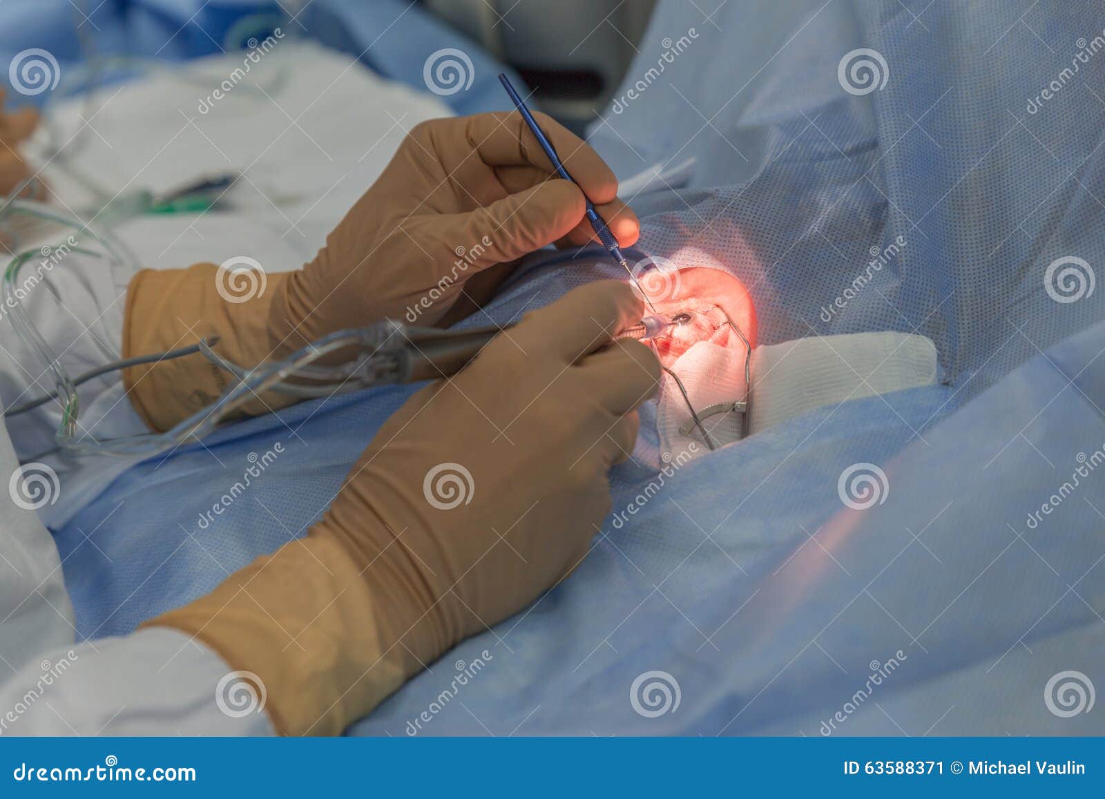 Opthtalmology Cataract Operation Stock Image - Image of male ...