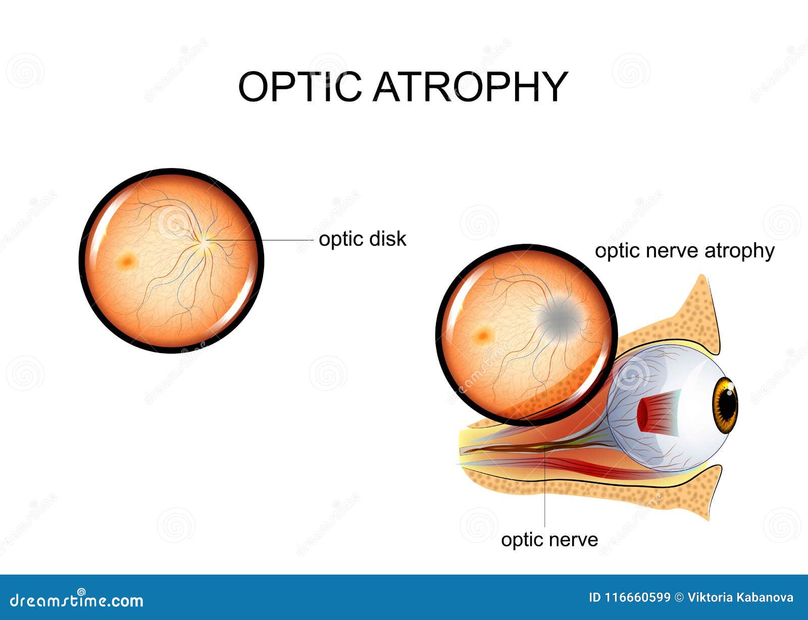 Optic nerve atrophy stock vector. Illustration of eyeground - 116660599