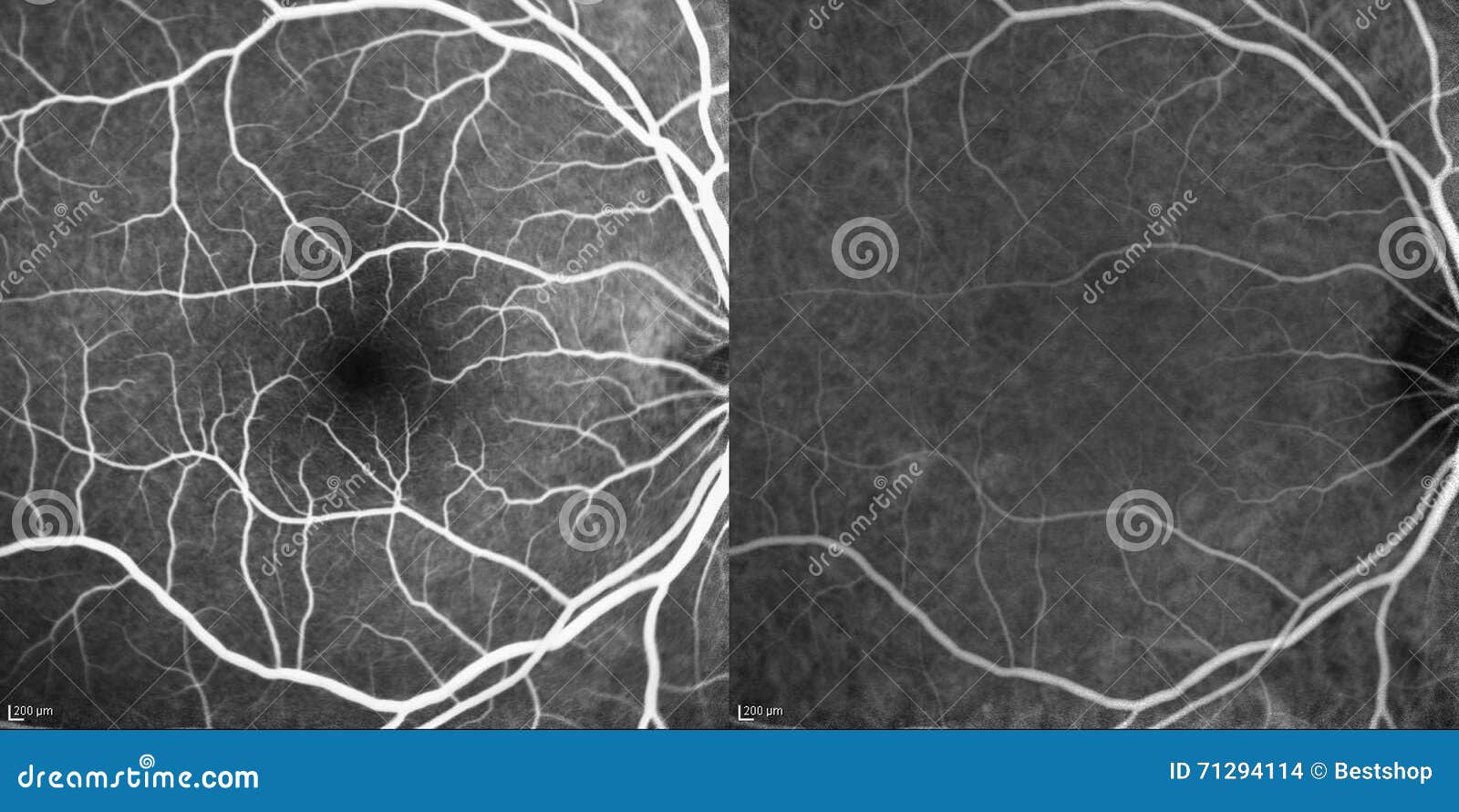 Optical Coherence Tomography Oct Image Angiography Catheter Lab ...