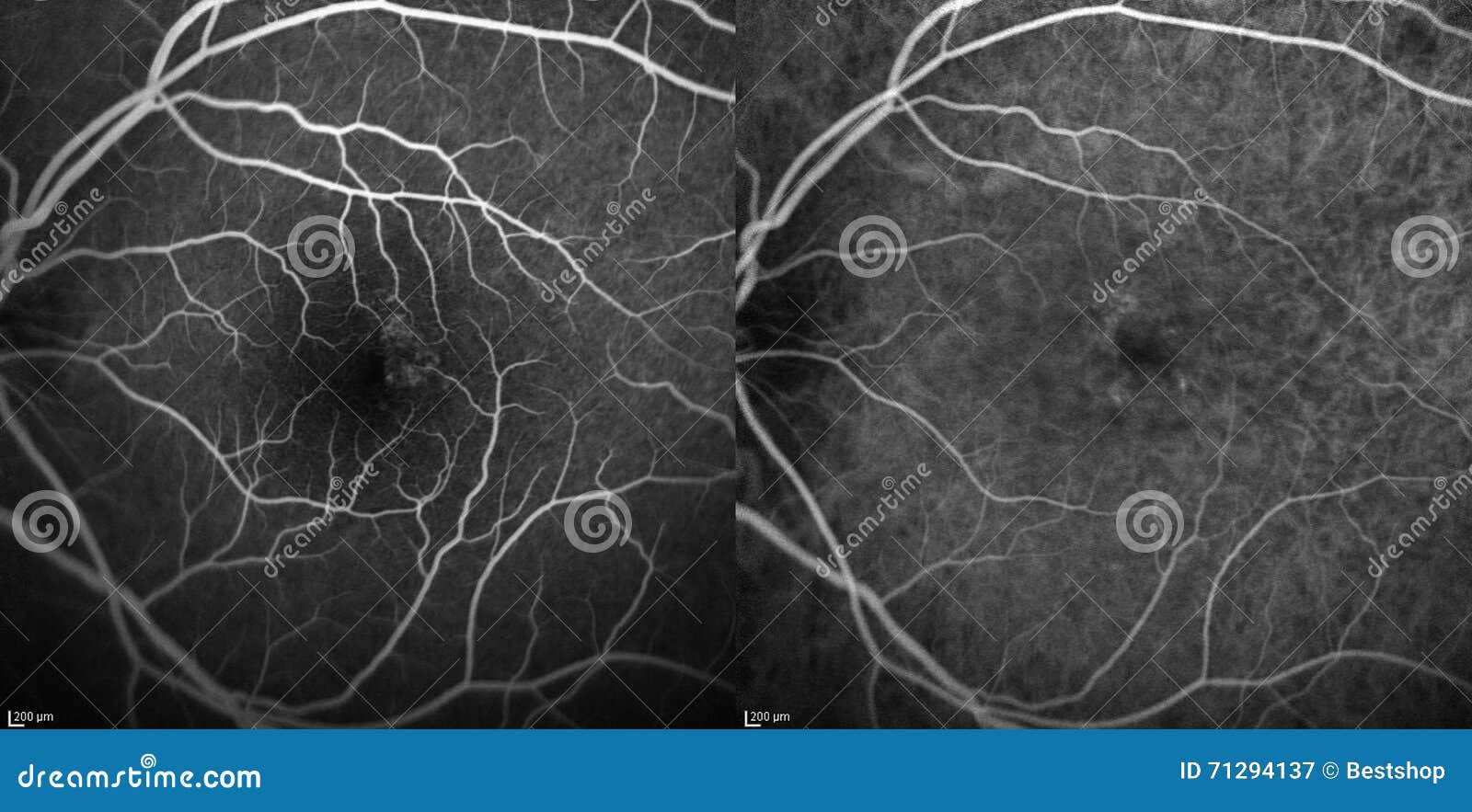 Optical Coherence Tomography Oct Image Angiography Catheter Lab ...