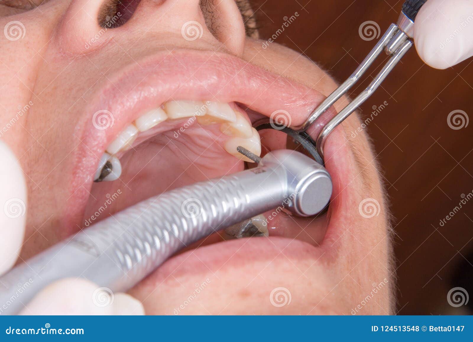 Oral Rehabilitation Process, Partial Removable Prosthesis Stock Photo ...