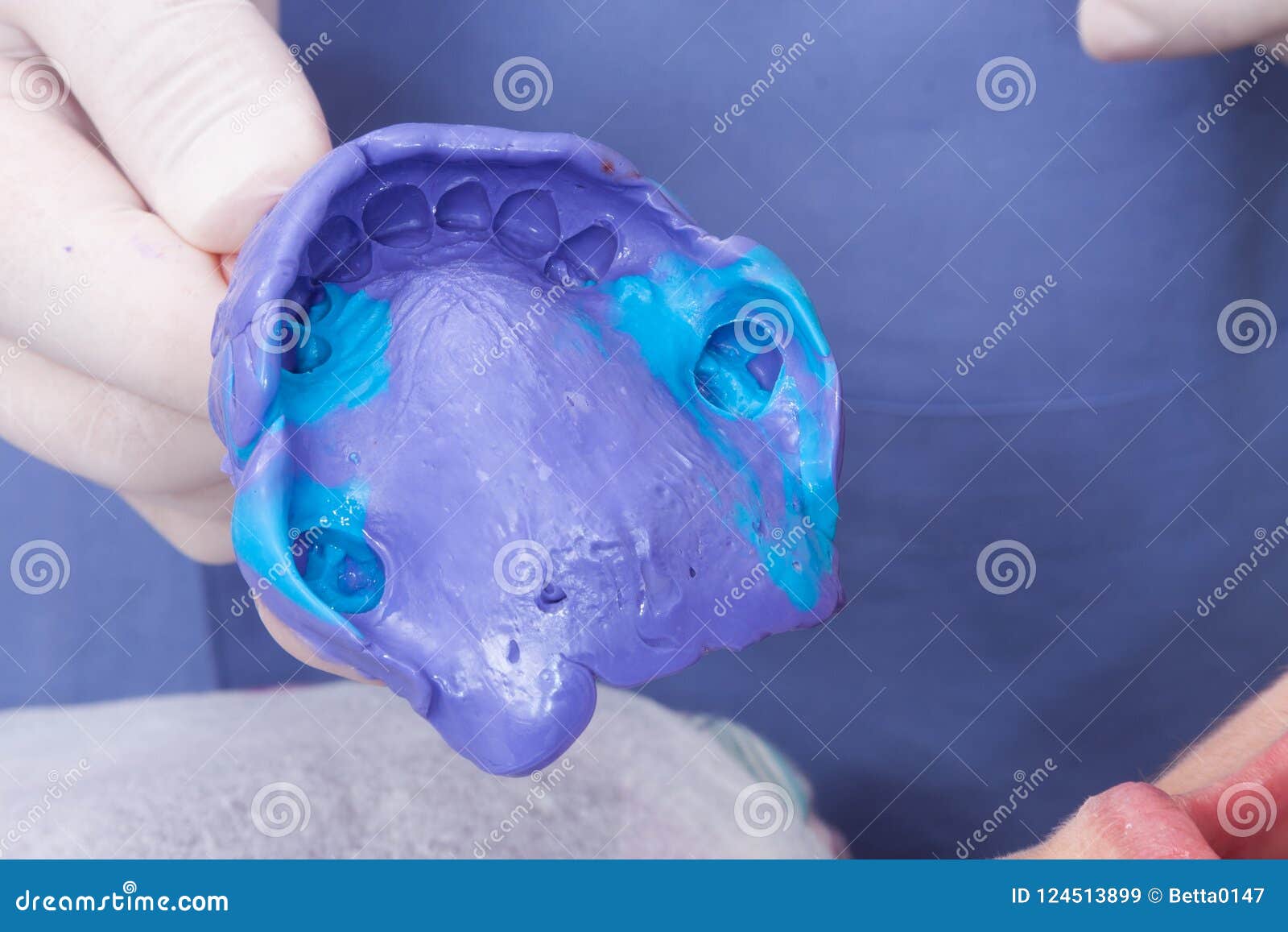 Oral Rehabilitation Process, Partial Removable Prosthesis Stock Image ...