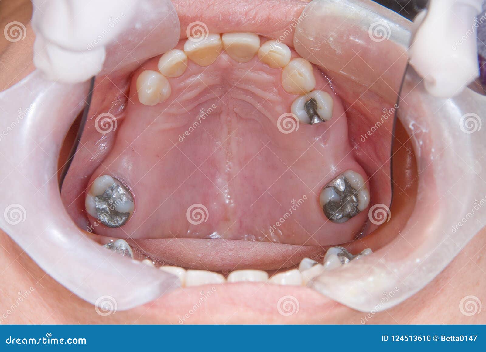 Oral Rehabilitation Process, Partial Removable Prosthesis Stock Photo ...