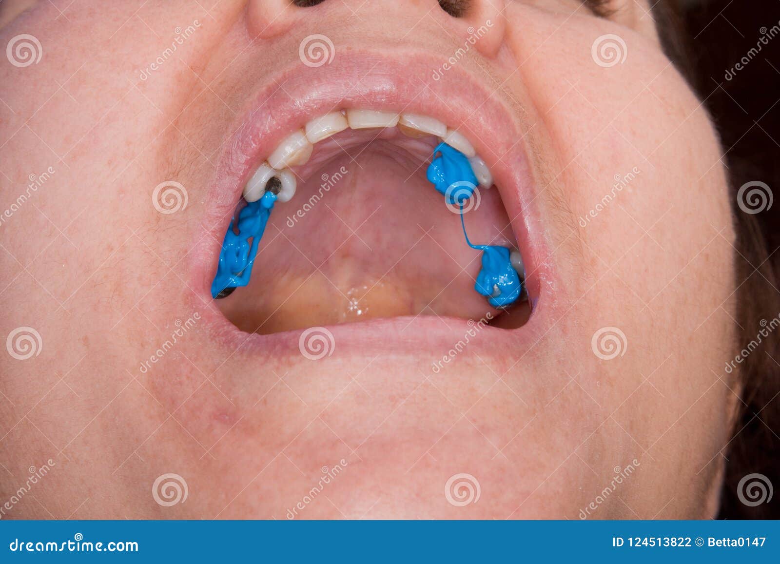 Oral Rehabilitation Process, Partial Removable Prosthesis Stock Photo ...