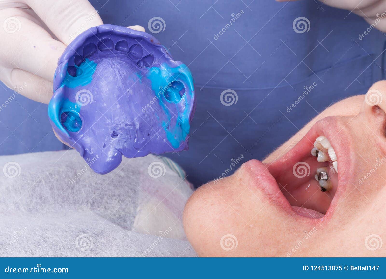 Oral Rehabilitation Process, Partial Removable Prosthesis Stock Image ...