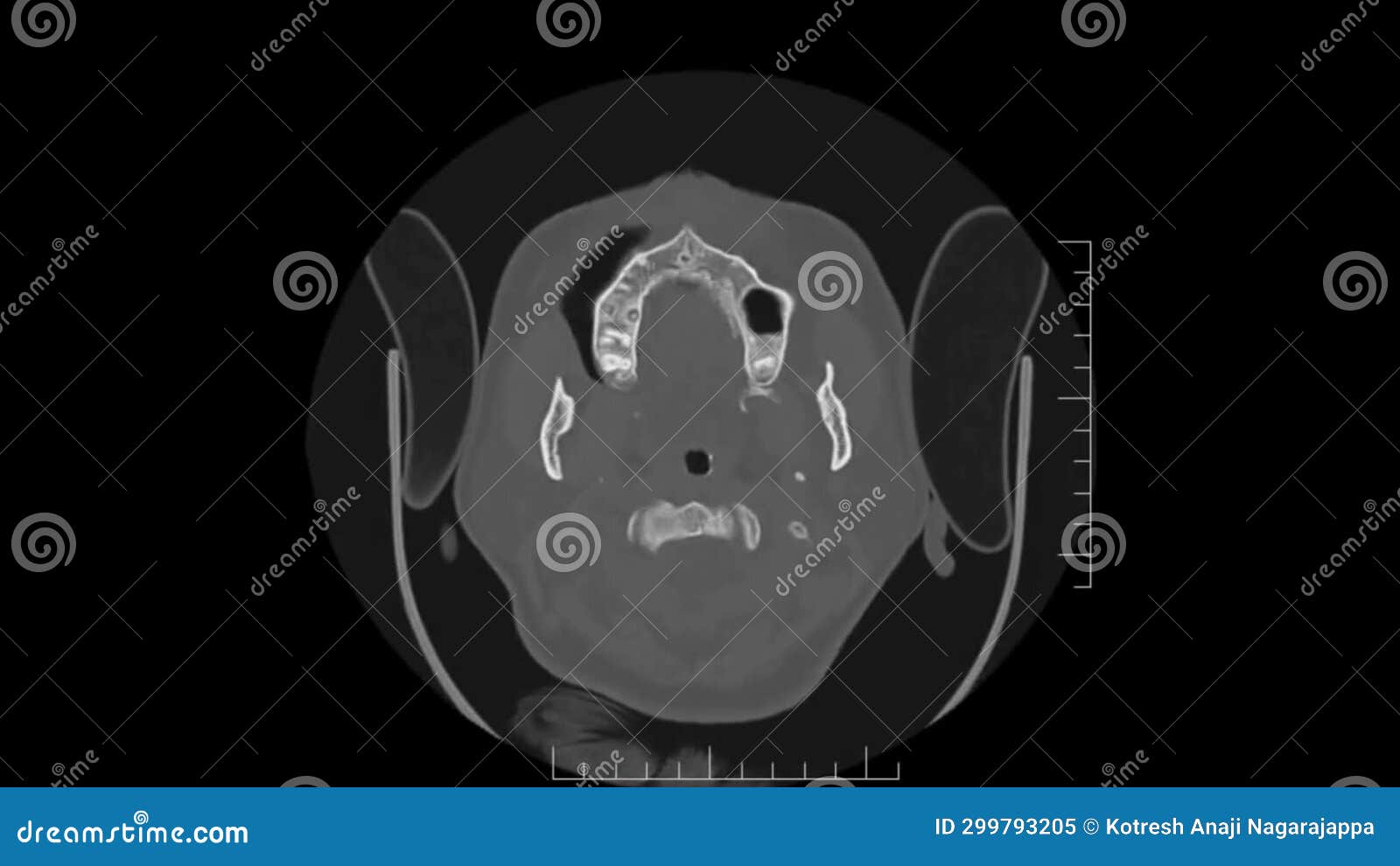 Orbit CT Scan Plain Bone Thin Sequence Stock Video - Video of ...
