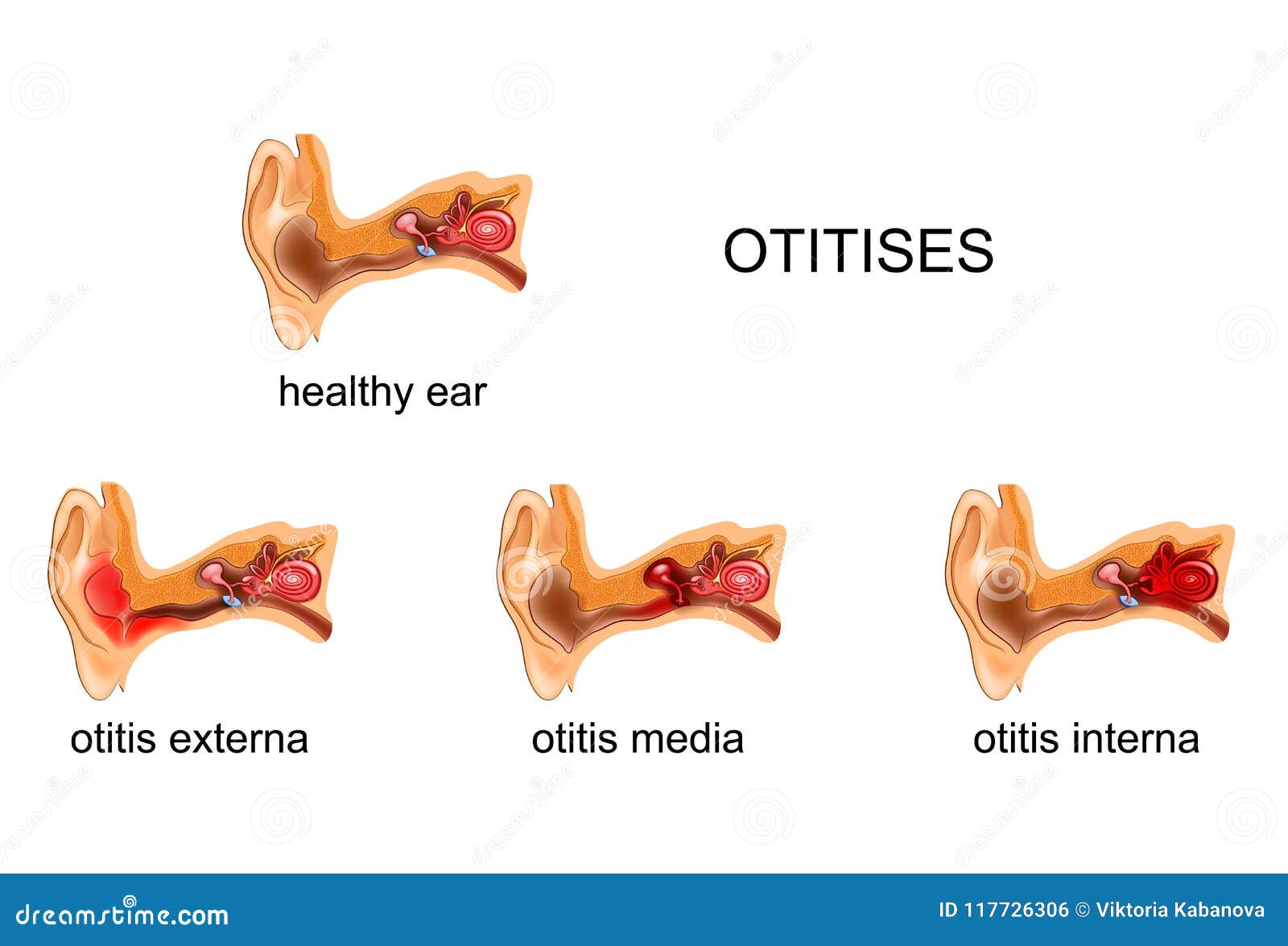 Oreille Media D'otitis, Interne, Externe, Illustration de Vecteur ...