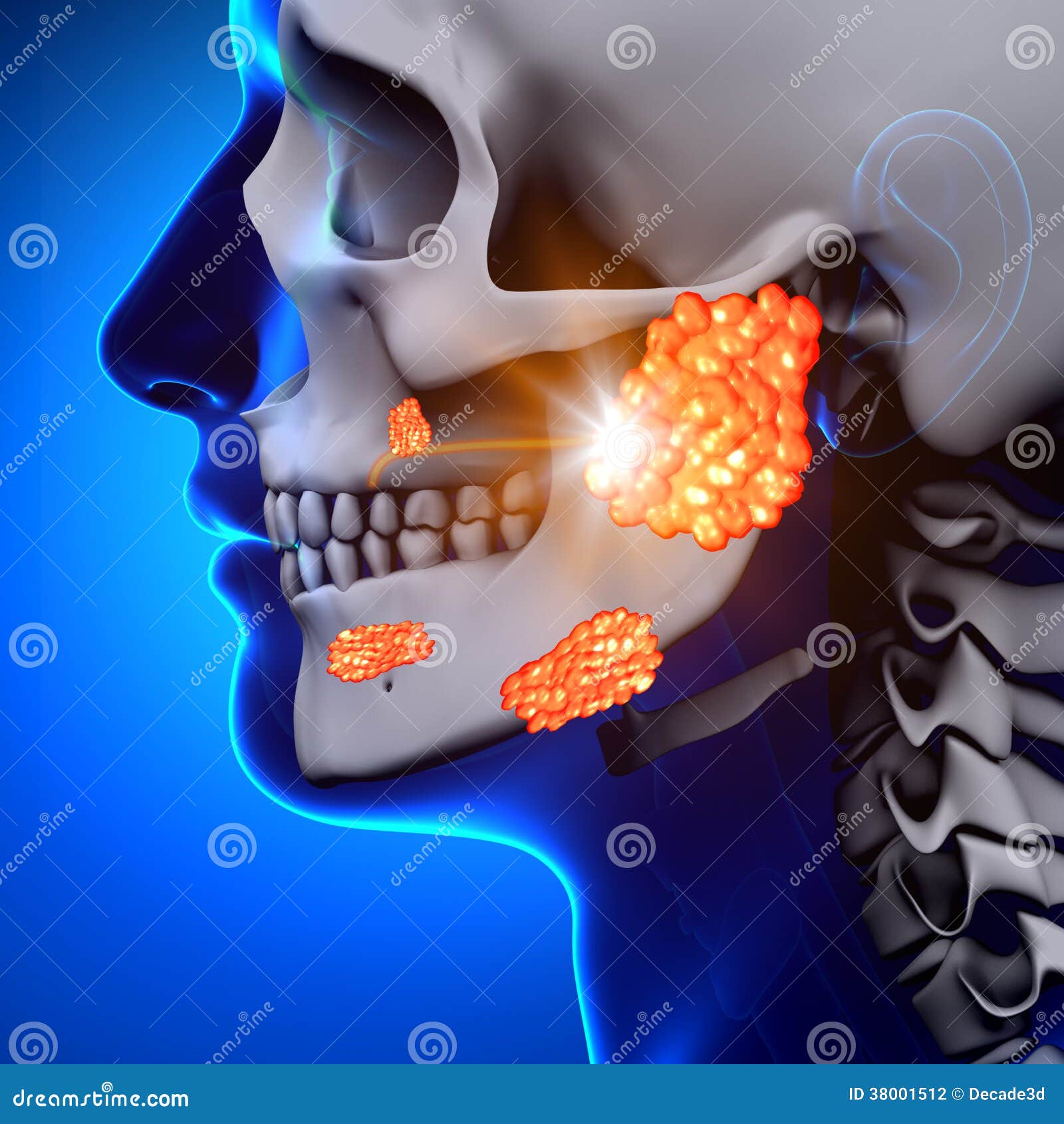 Oreillons/glande Parotide - Maladie Illustration Stock - Illustration ...
