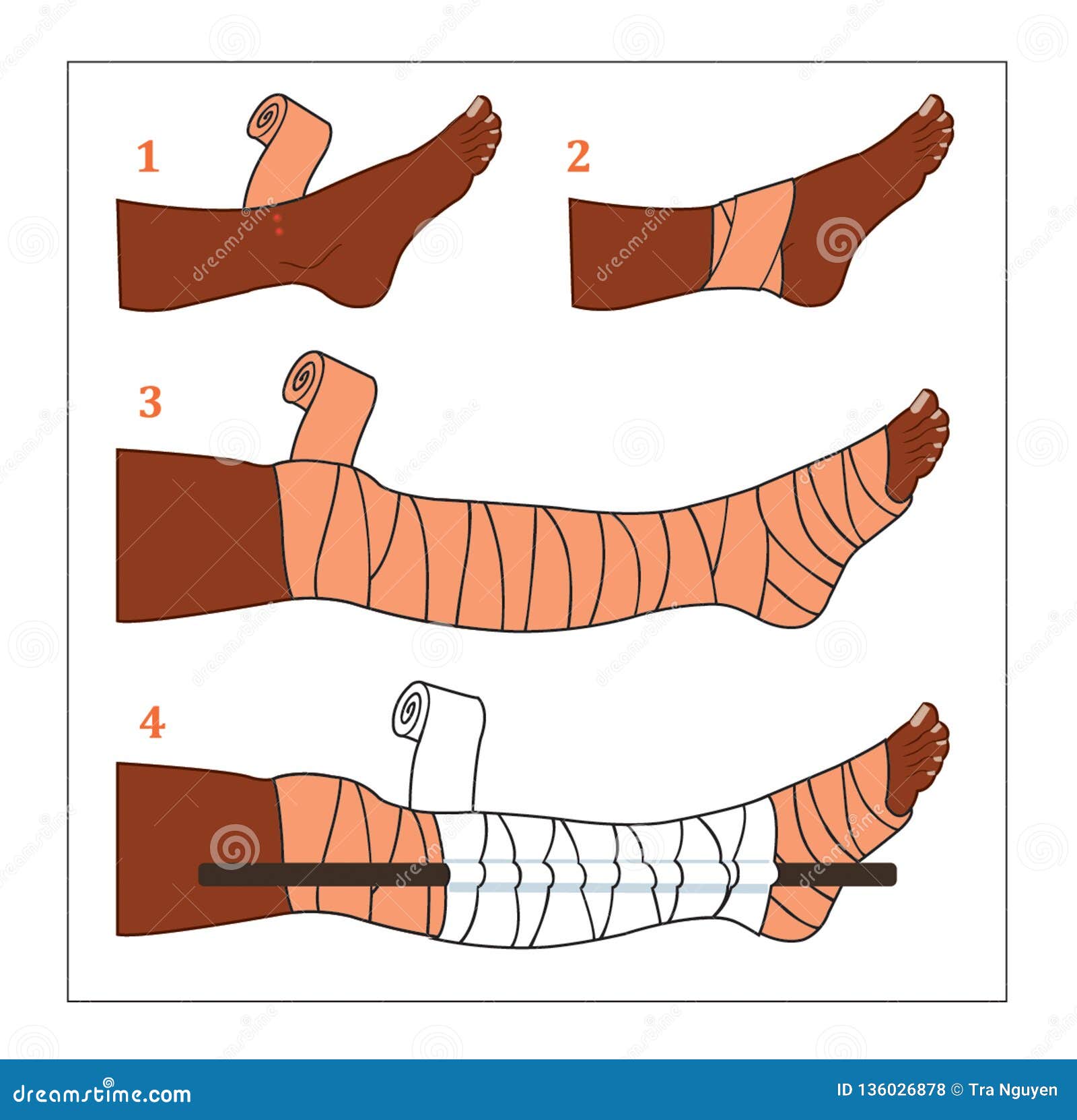 Common First Aid Situation - R.I.C.E Strategy Stock Image ...