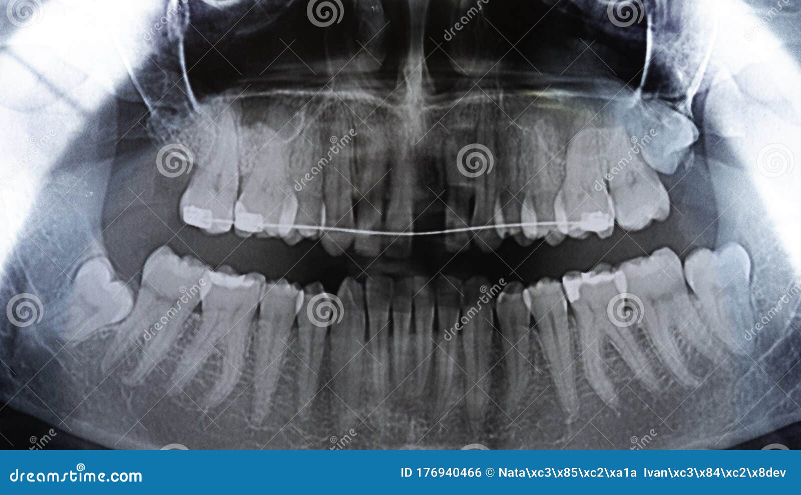 Original Black and White X-ray Teeth Scan. Upper Teeth with Dental ...