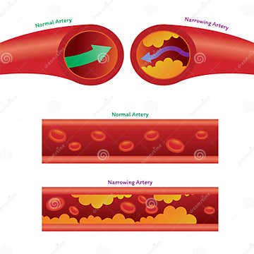 Normal Artery and Narrow Artery because Cholesterol Fat Cell Stock ...