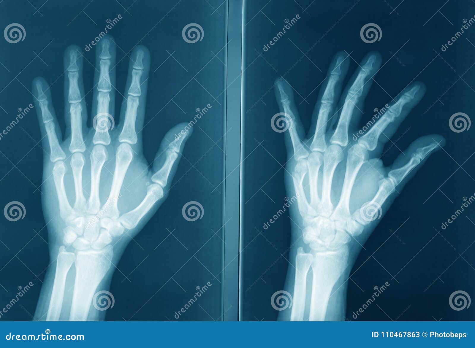 Original Radiography of Human Hand Stock Image - Image of cure, care ...