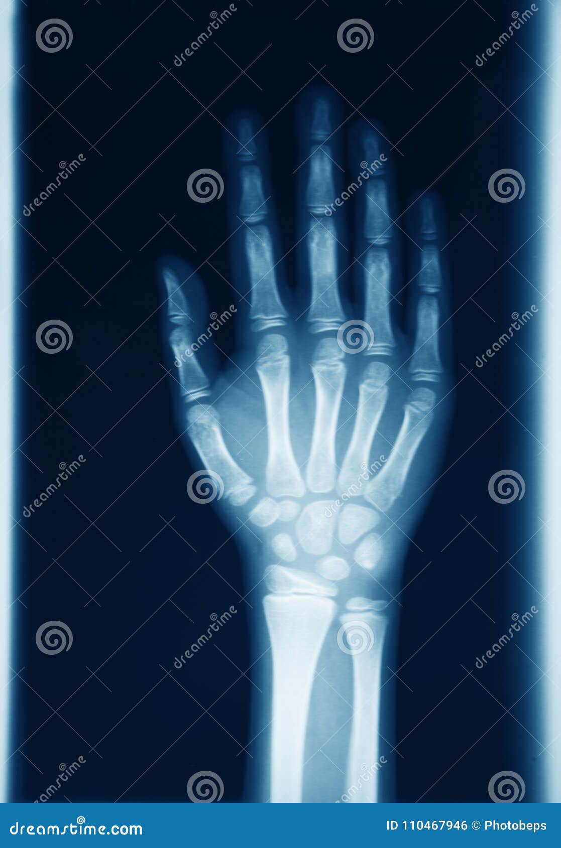 Original Radiography of Human Hand Stock Photo - Image of hospital ...