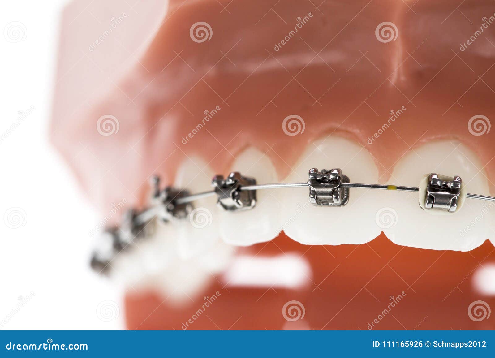 Orthodontic Braces and Brackets Stock Photo - Image of objects ...