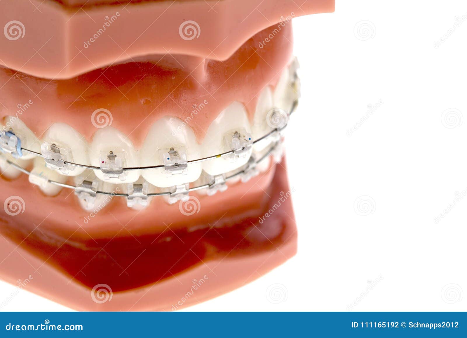 Orthodontic Braces and Brackets Stock Photo - Image of steel ...