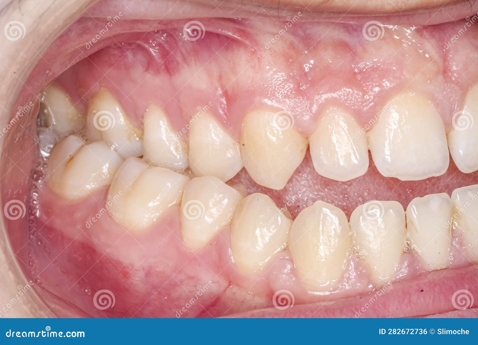 Orthodontic condition stock photo. Image of organ, cross - 282672736