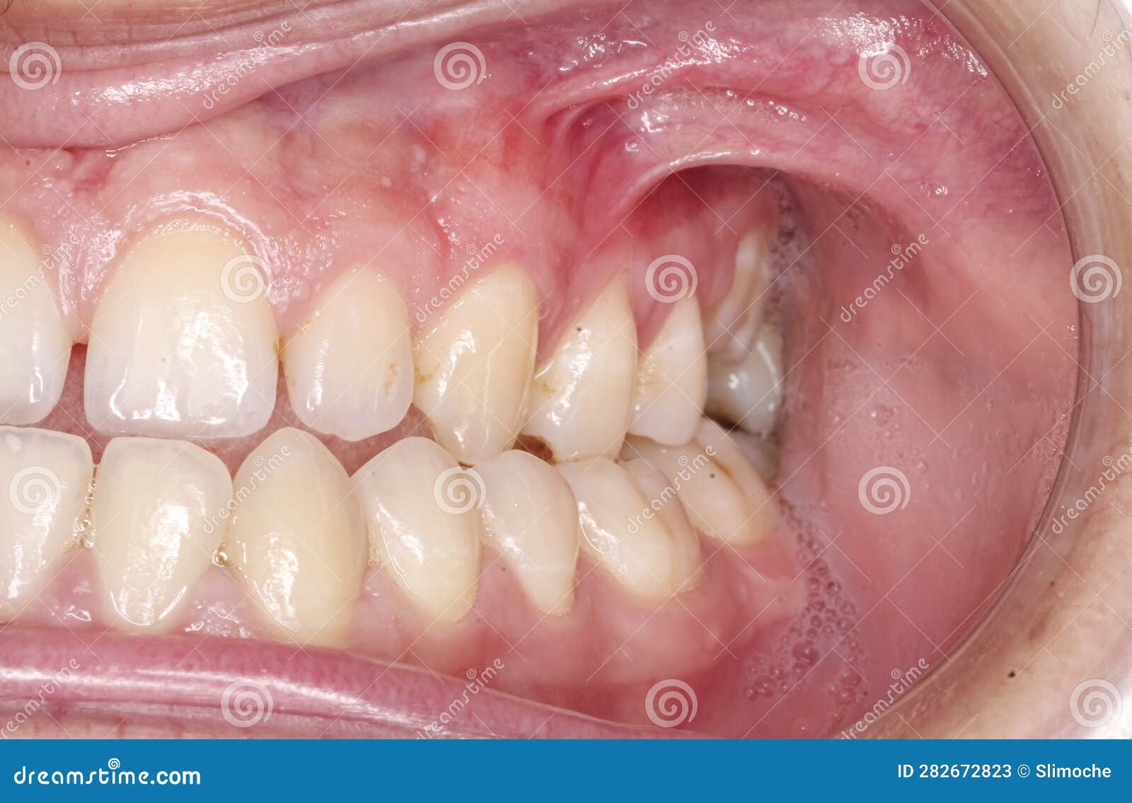 Cat Teeth With Gingival Retraction After Calicivirus Infection Stock ...