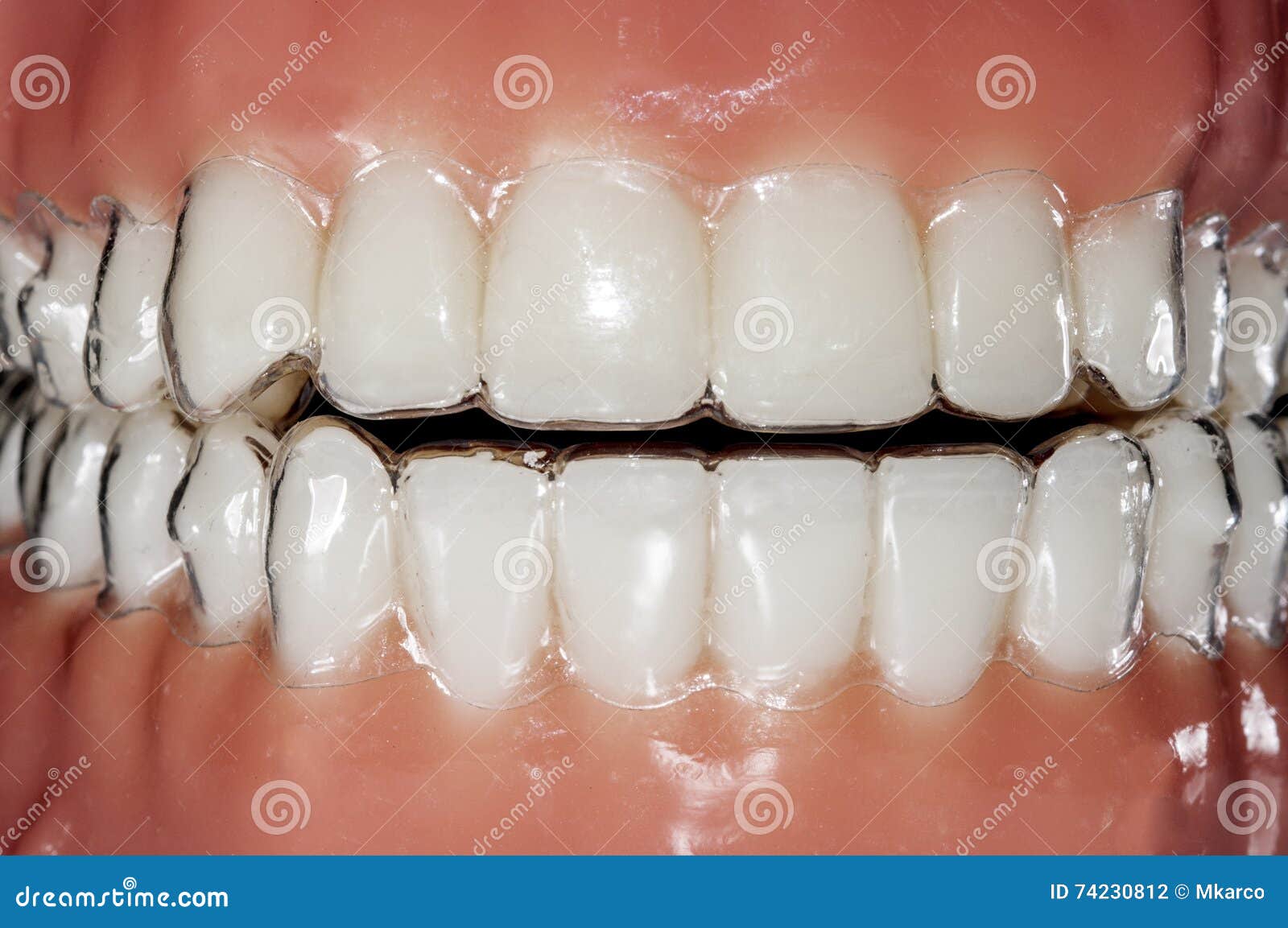 Orthodontic Invisible Aligner for Teeth Treatment Stock Photo - Image ...