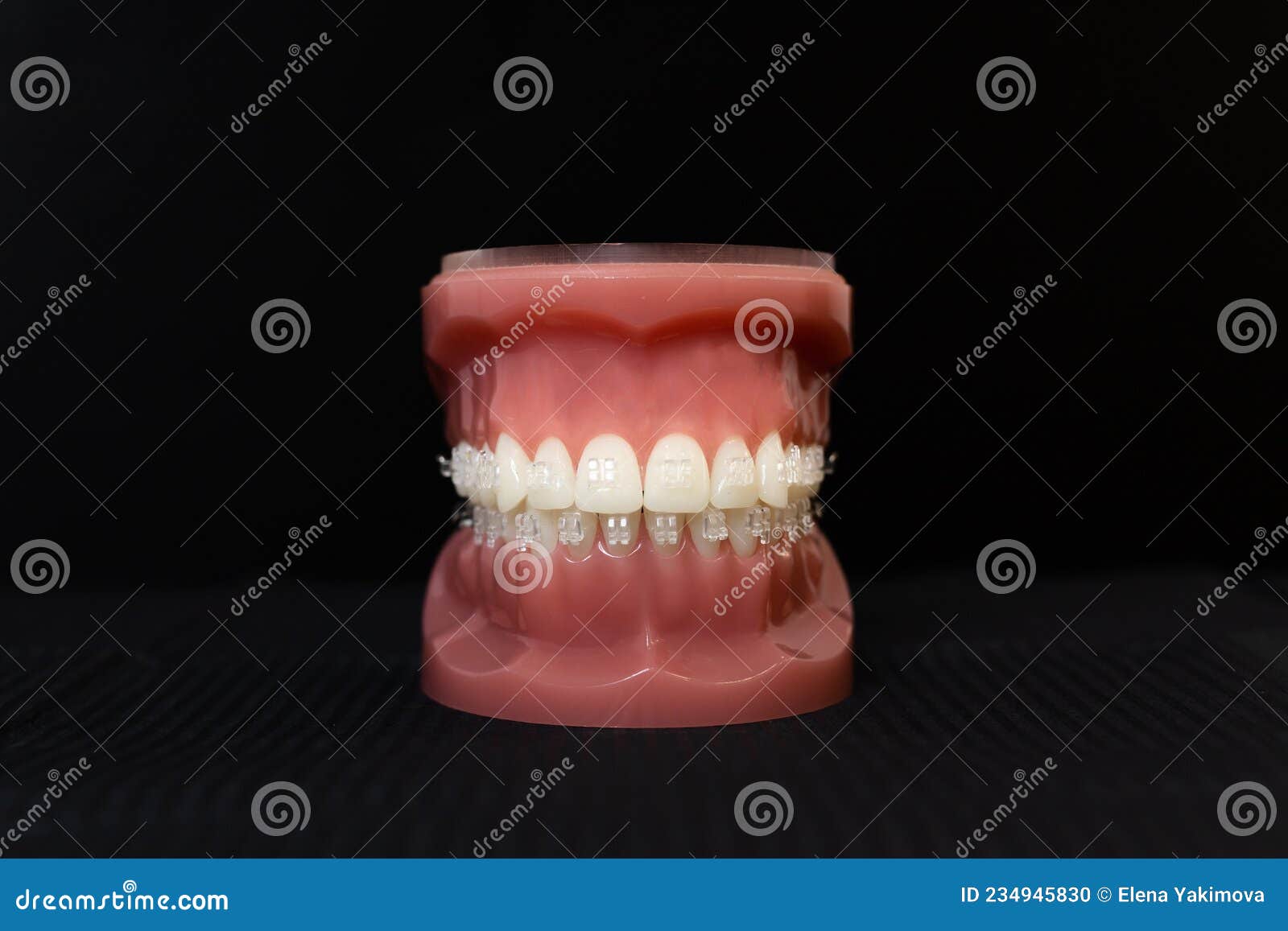 Orthodontic Jaw Model, Demonstration Teeth With Ceramic Bracket Or ...