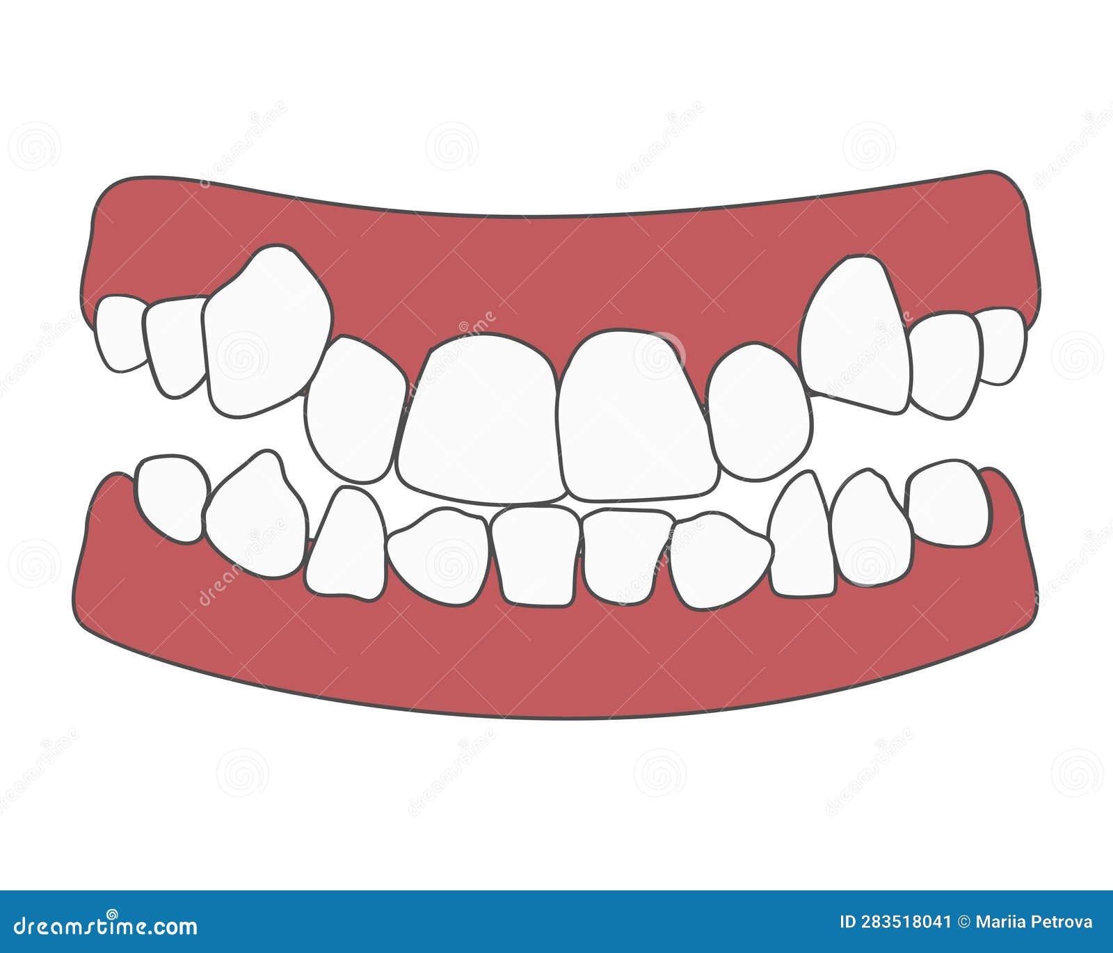 Orthodontic Problem Teeth Crowding. Abnormal Eruption Cartoon Vector ...