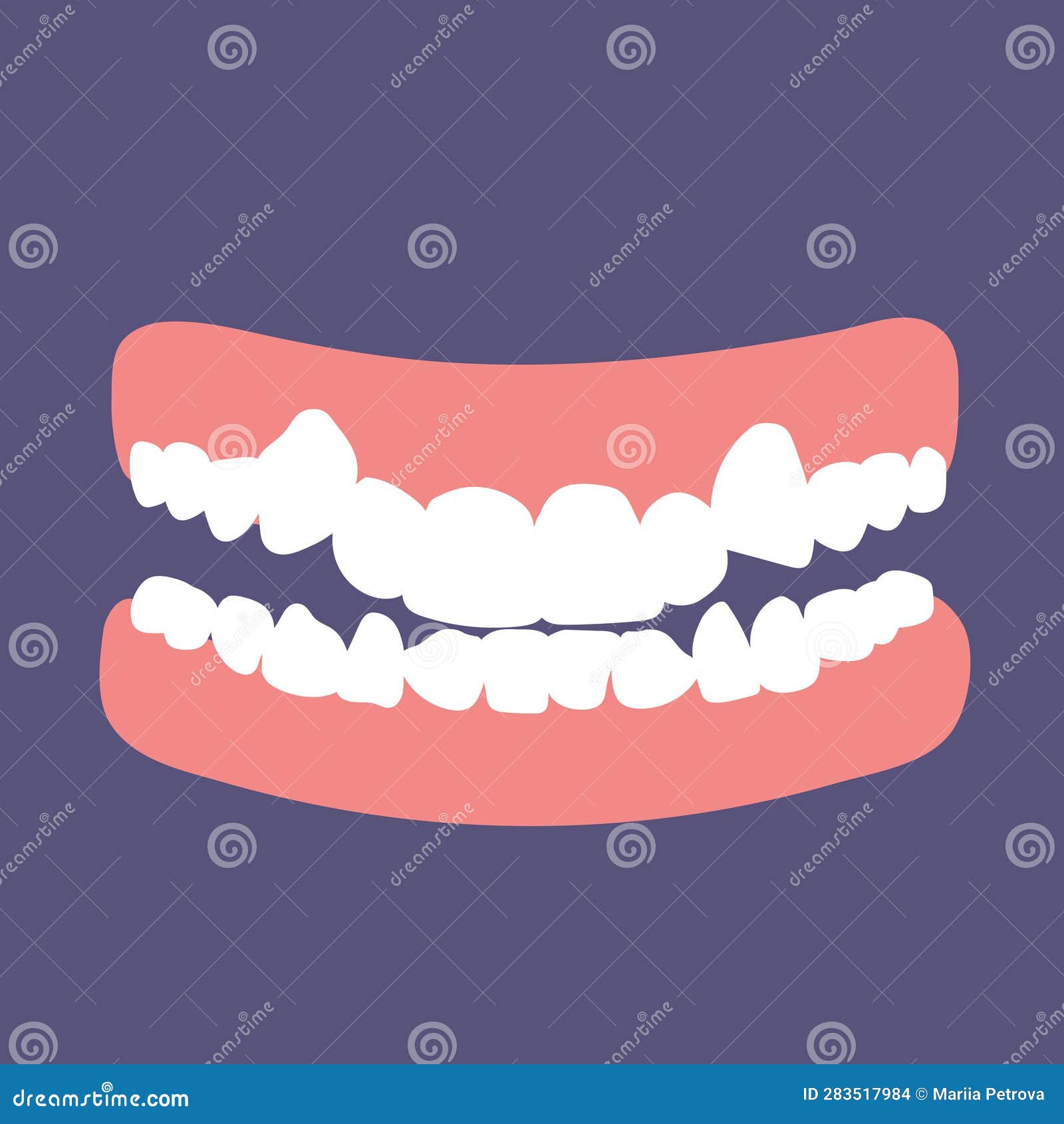 Orthodontic Teeth Problem Crowding. Abnormal Eruption Stock Vector ...