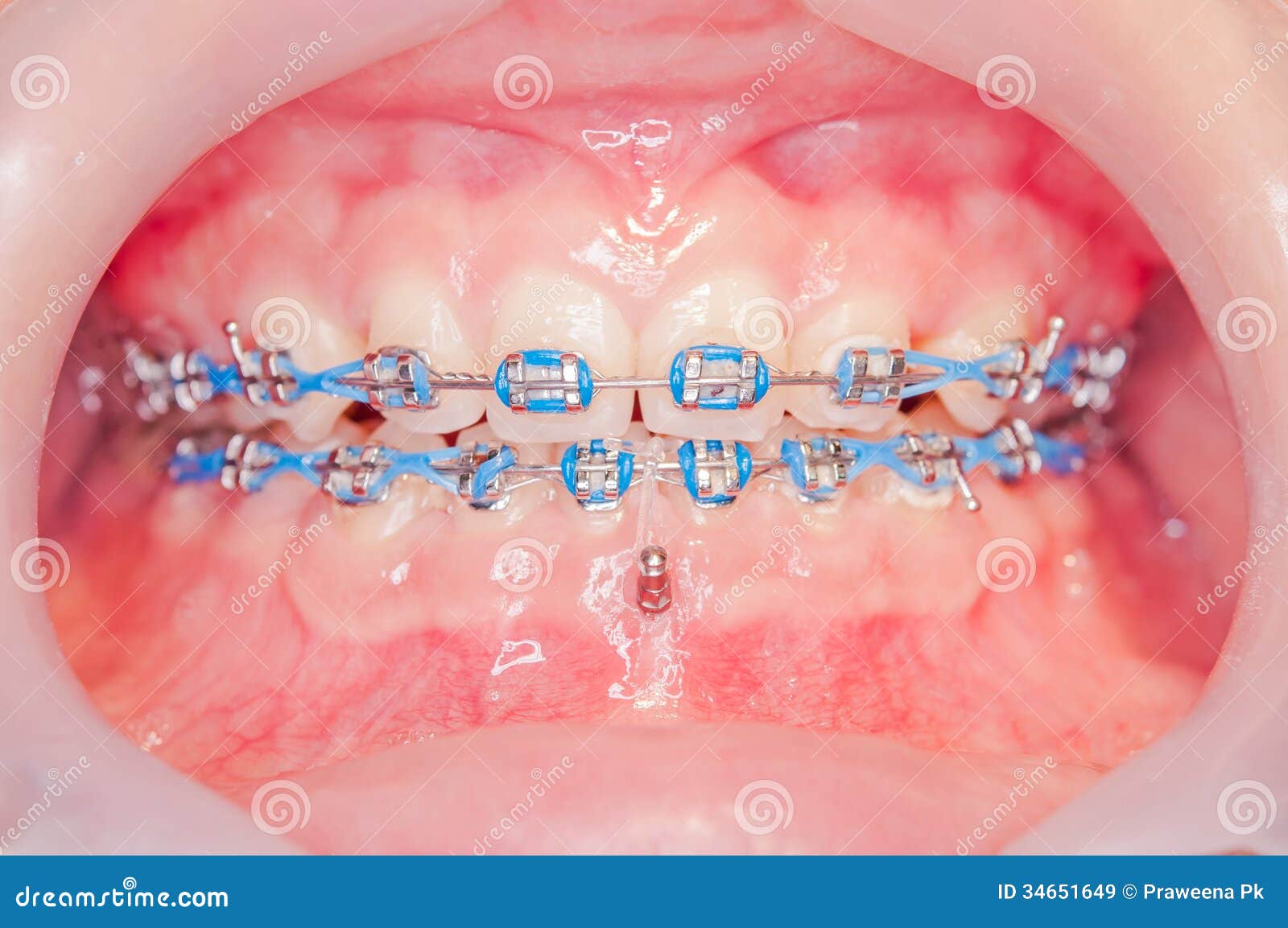 Orthodontics Procedure with Miniscrew. Stock Image - Image of doctor ...