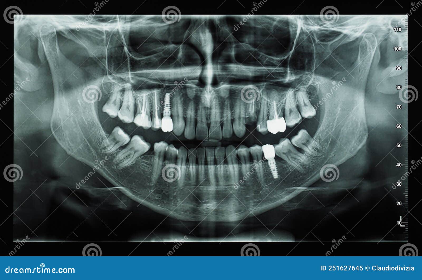 Orthopantomograph Panoramic Image Radiograph of Teeth Stock Image ...