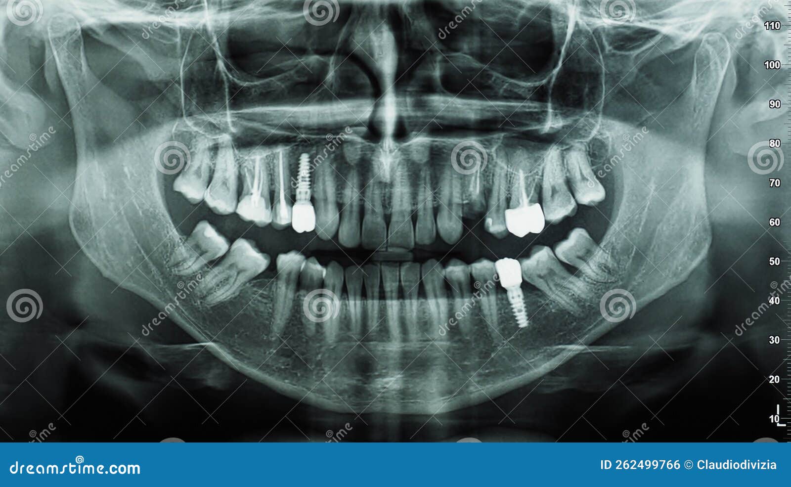 Orthopantomograph Panoramic Image Radiograph of Teeth Stock Photo ...