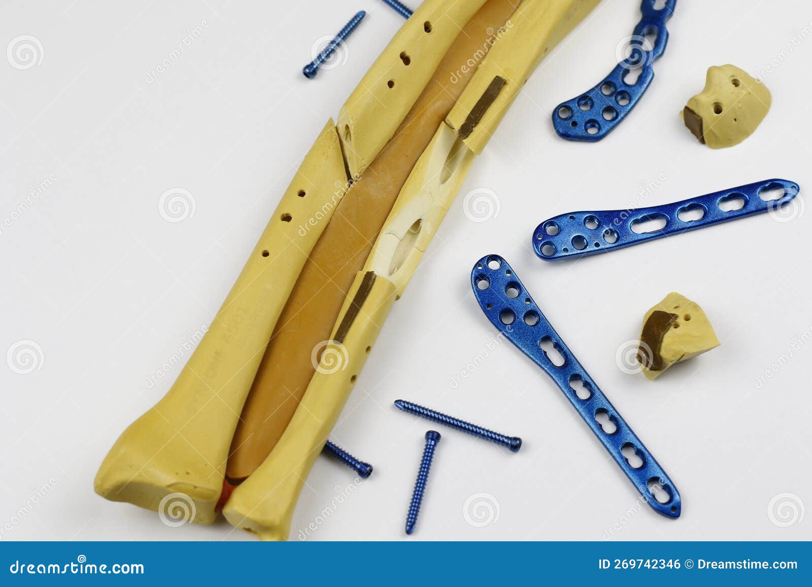 Orthopedic bone implants stock photo. Image of metal - 269742346