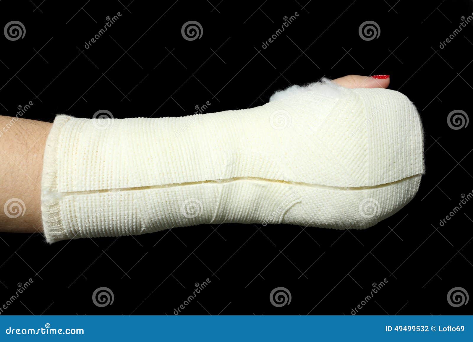 Orthopedic cast stock photo. Image of surgical, medical - 49499532