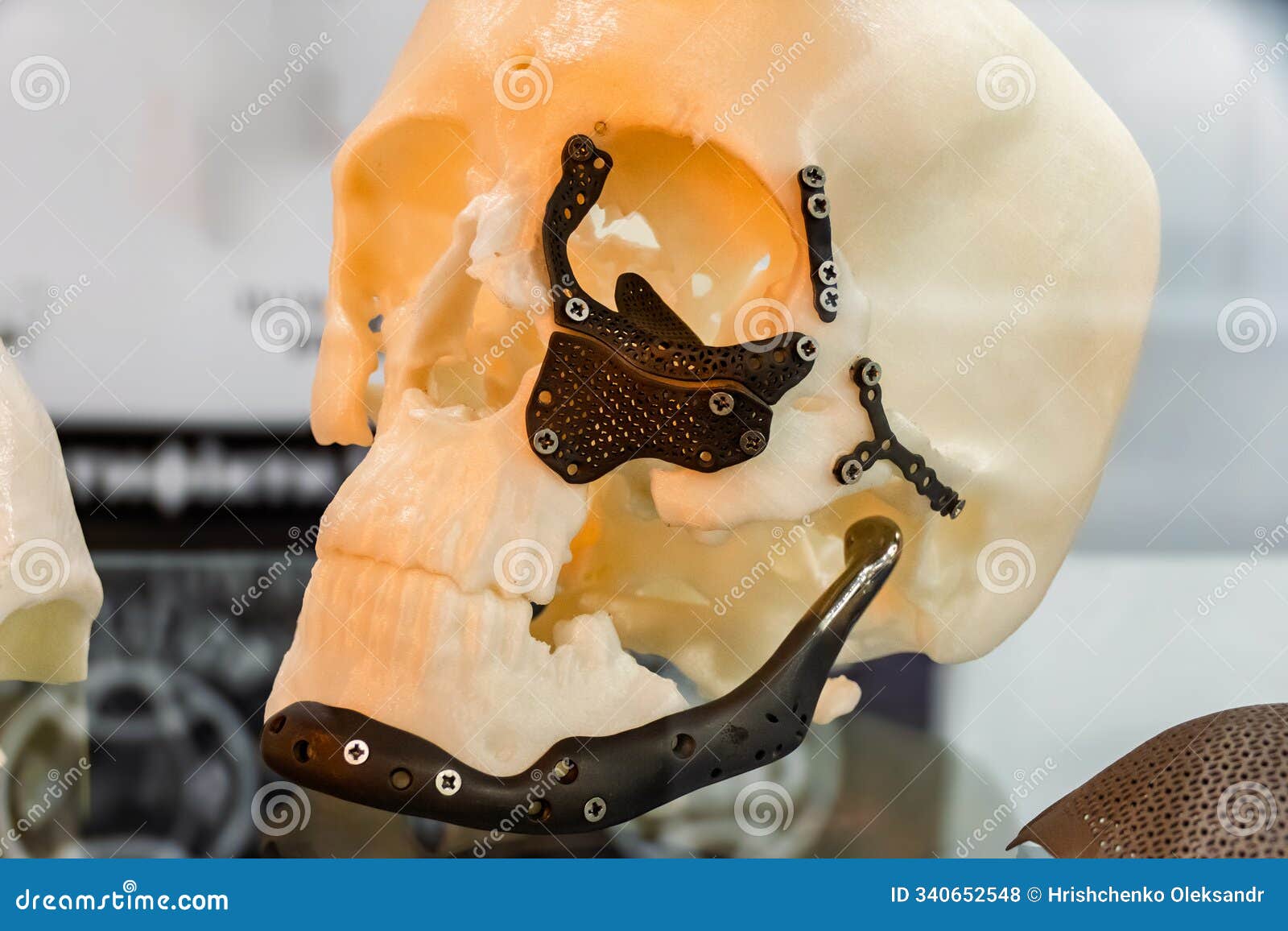 Orthopedic Implants and Individual Titanium Cranioplasties Printed on a ...
