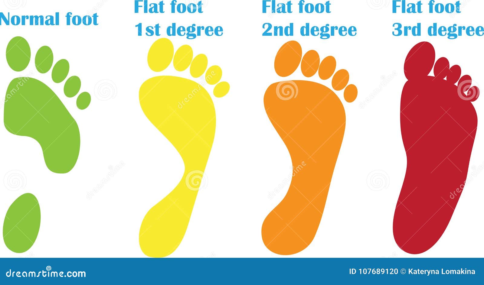 Orthopedic Steps of Flat Foot Stock Illustration - Illustration of ...