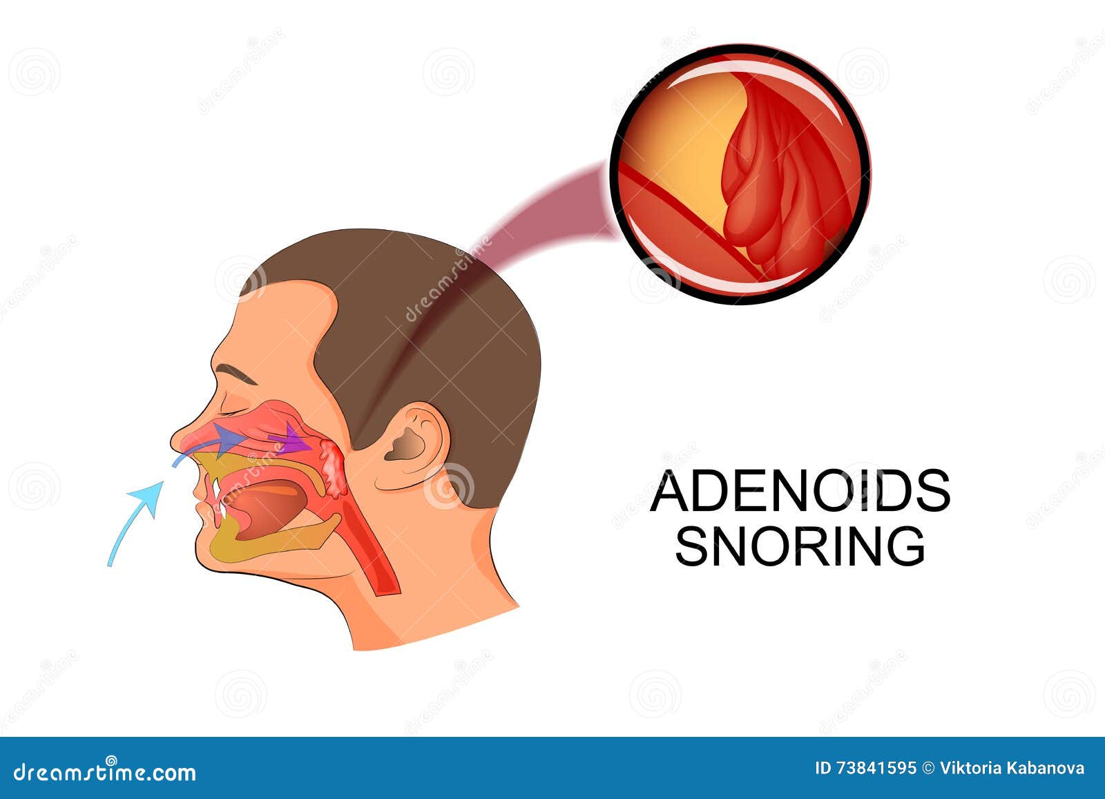 Os Adenoides Causam Ressonar Ilustração do Vetor - Ilustração de ronco ...