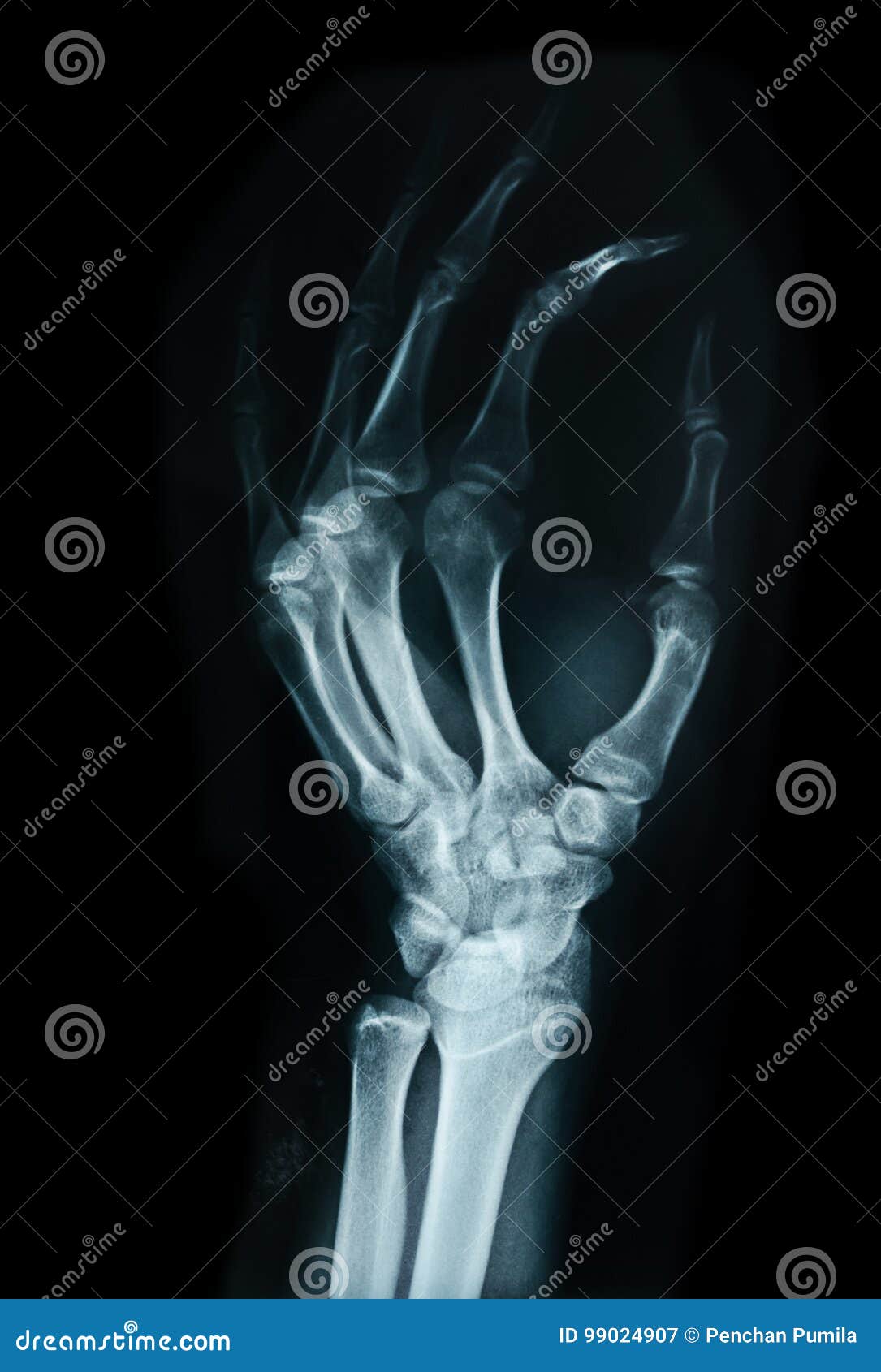 Os de Carpal X Ray humain image stock. Image du commun - 99024907