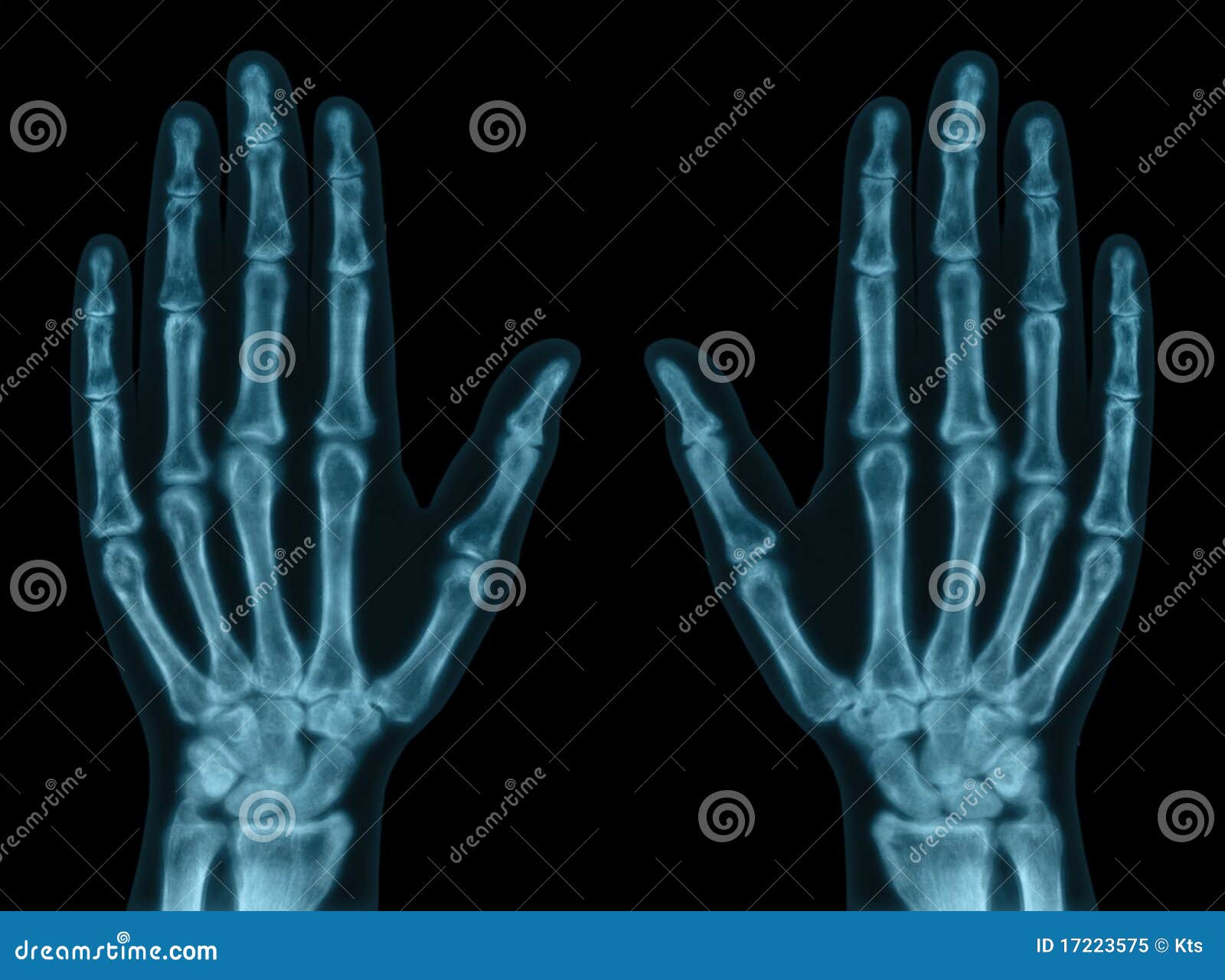 Os de main image stock. Image du radiologiste, radioactif - 17223575