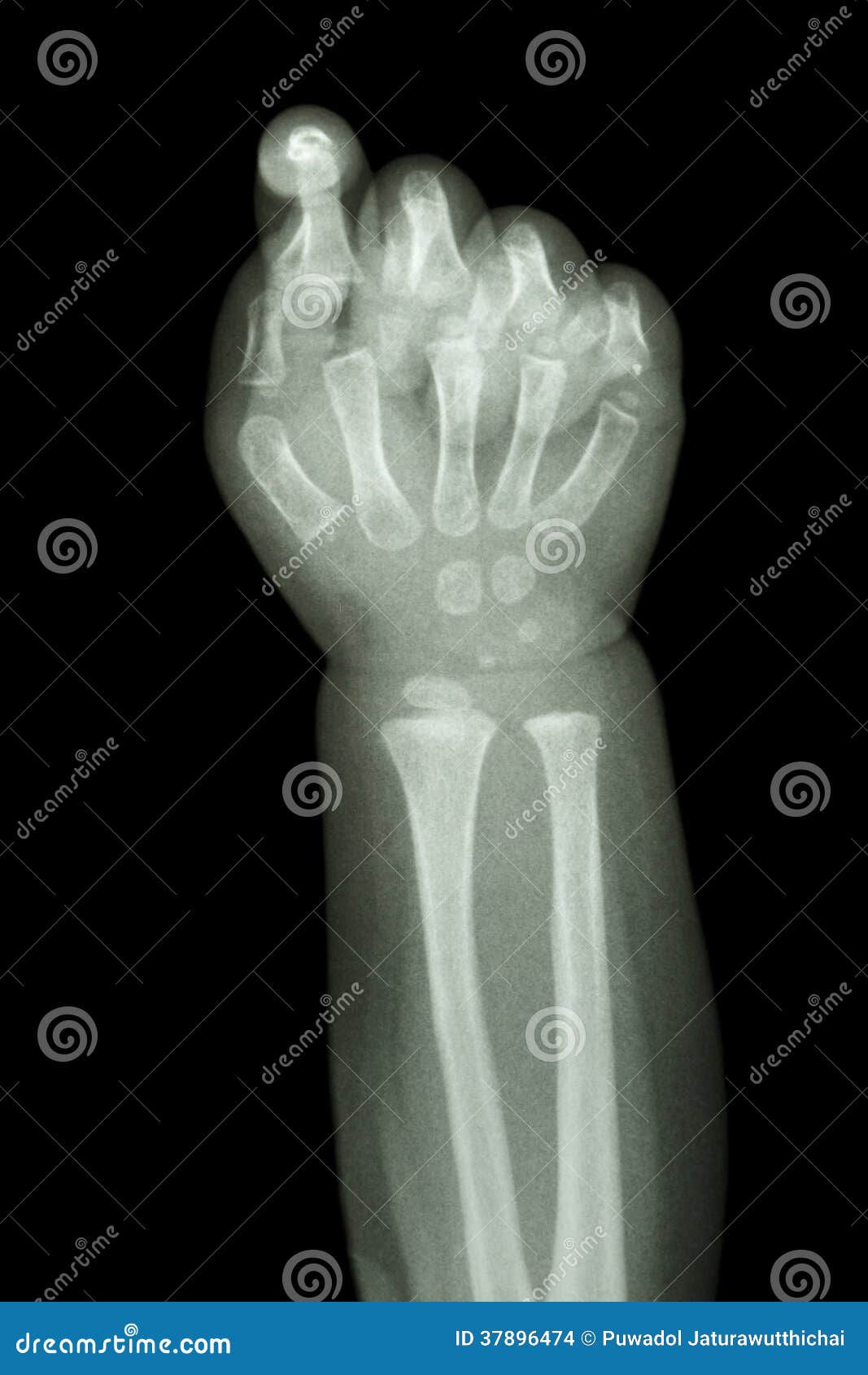 Os De Main Du Nourrisson Normal Photo stock - Image du médical, film ...