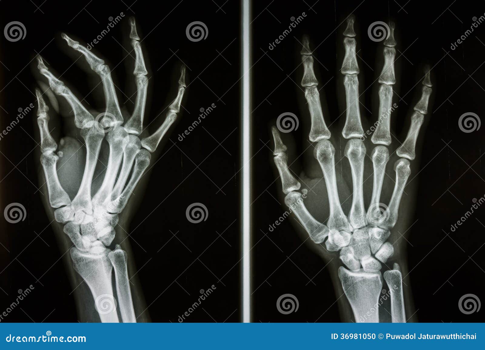 Ossa delle mani umane fotografia stock. Immagine di diagnosi - 36981050