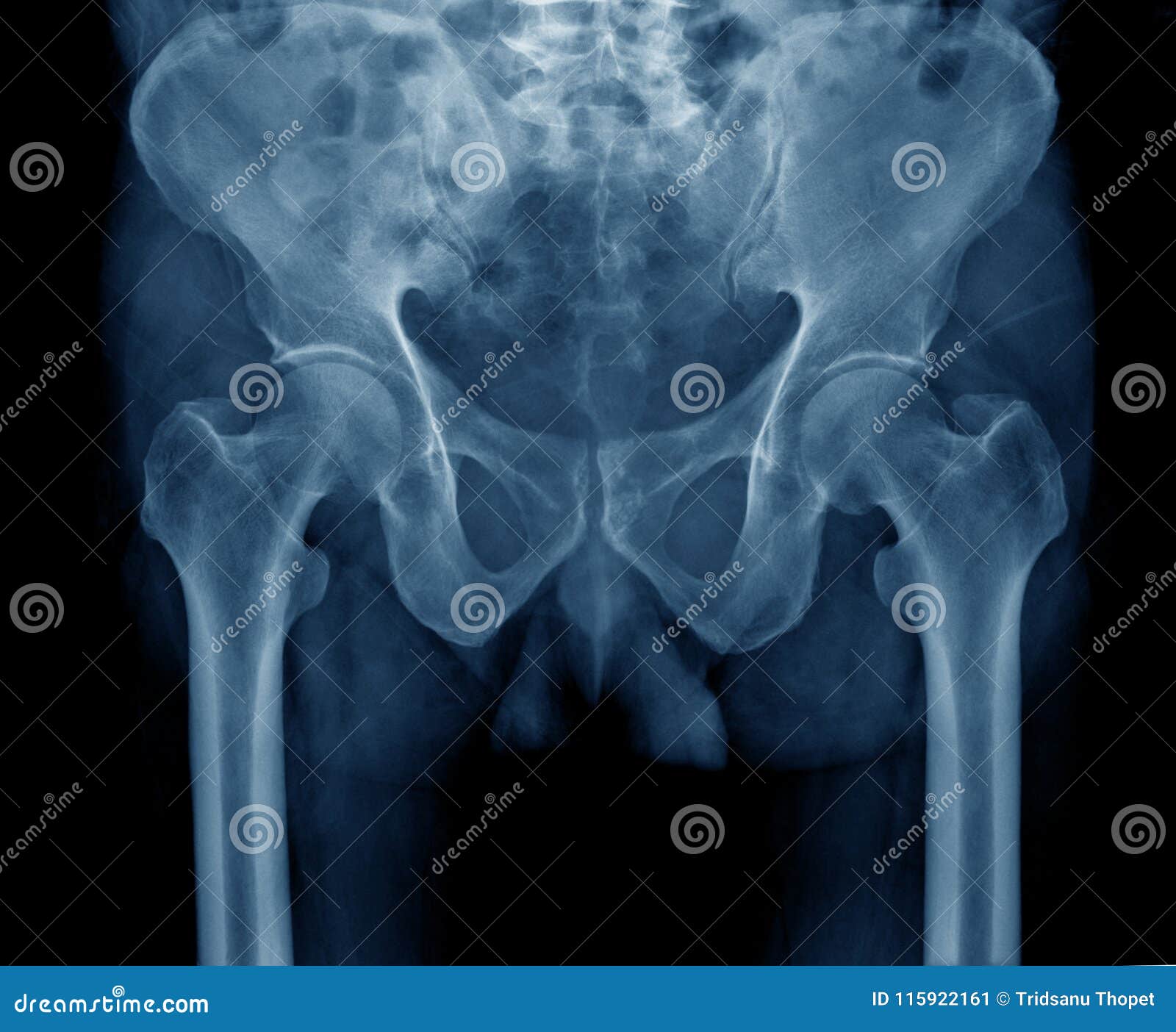 Osso anca e pélvico imagem de stock. Imagem de cirurgia - 115922161