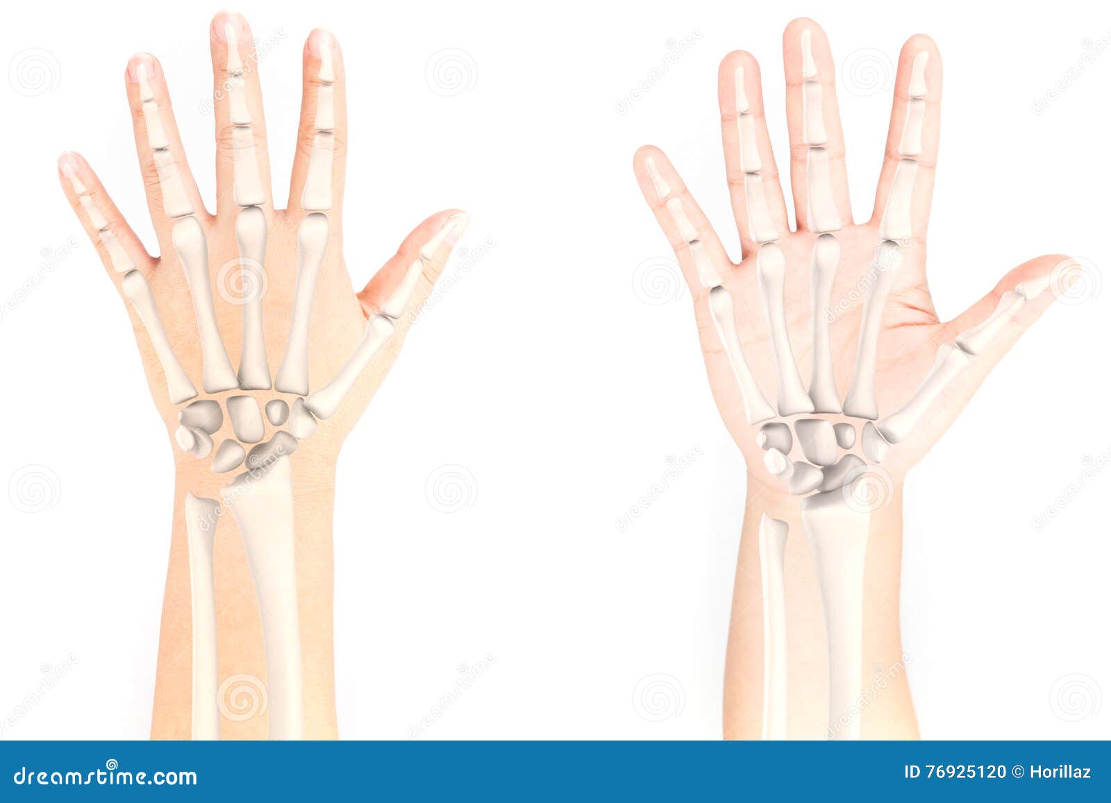 Osso de pulso foto de stock. Imagem de grampo, terapia - 76925120