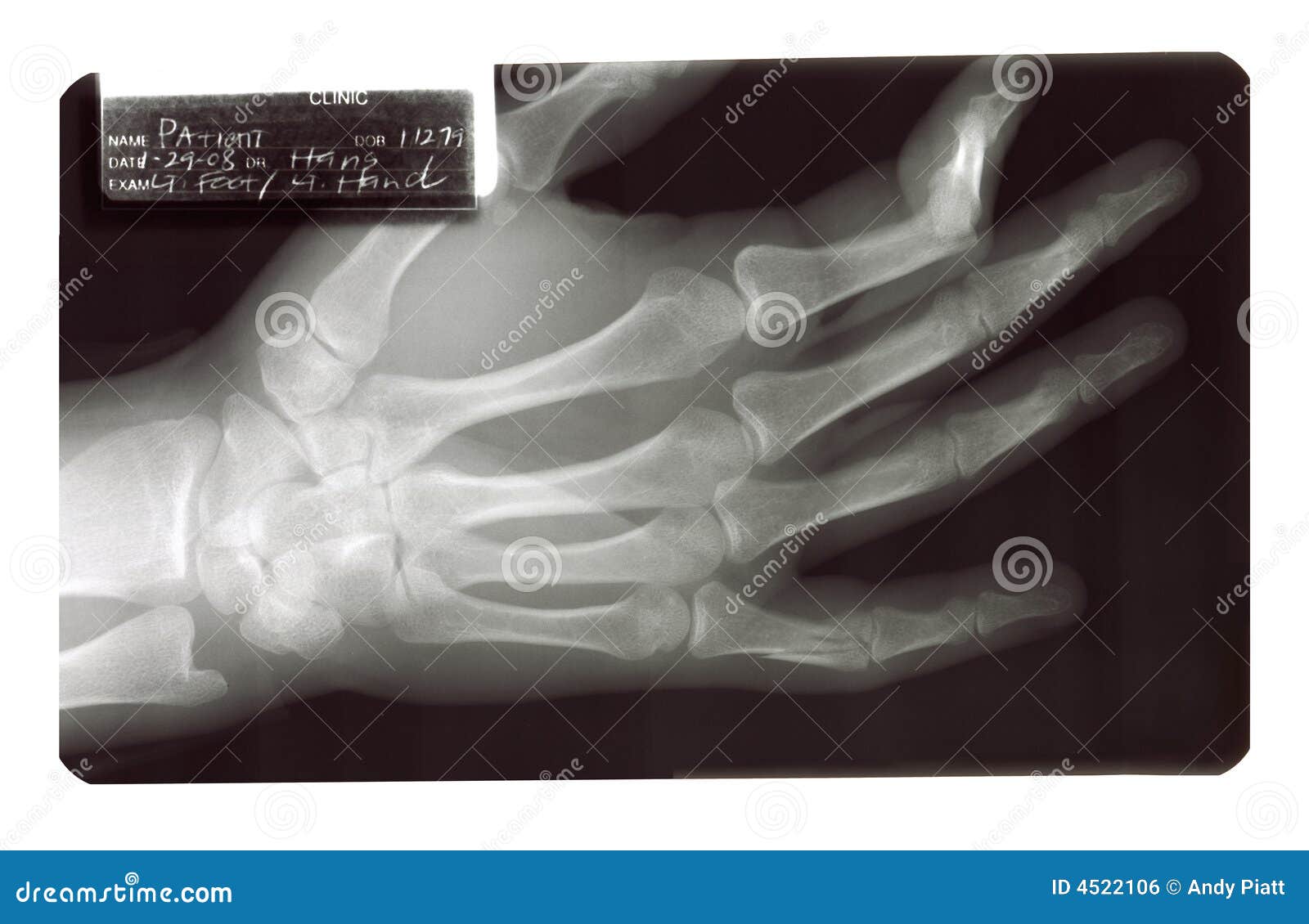 Osso Quebrado Raio X Do Dedo Foto de Stock - Imagem de médico ...