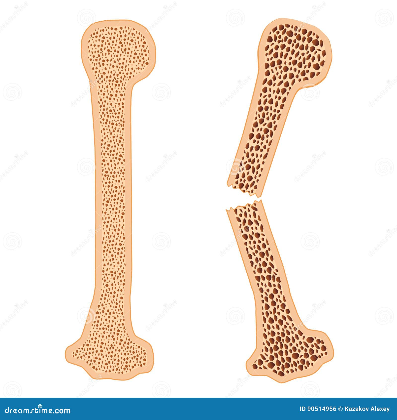 Osso Sano Ed Osso Rotto Con Osteoporosi Illustrazione Vettoriale ...