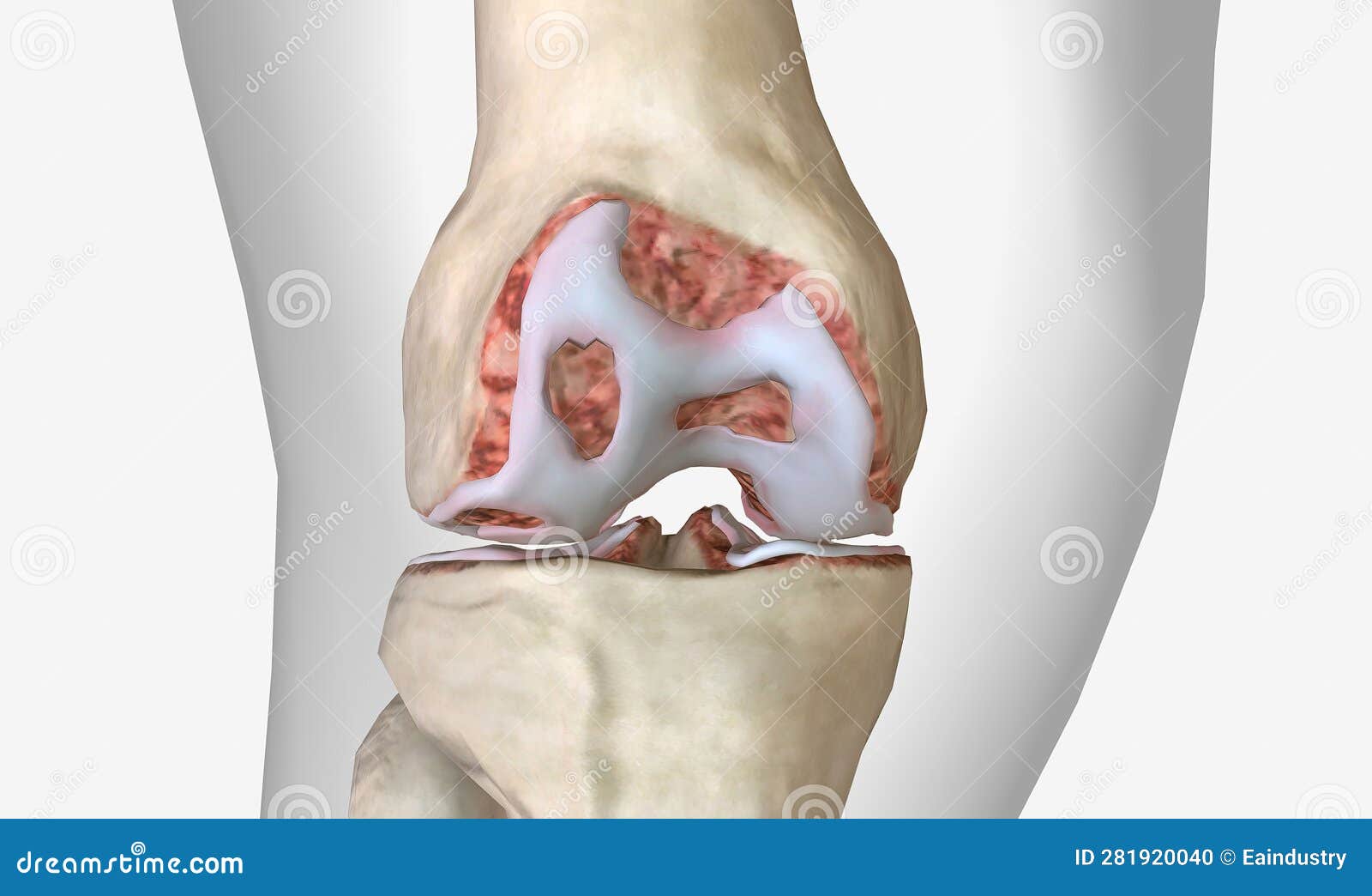 Osteoarthritis is a Degenerative Form of Arthritis that Affects ...