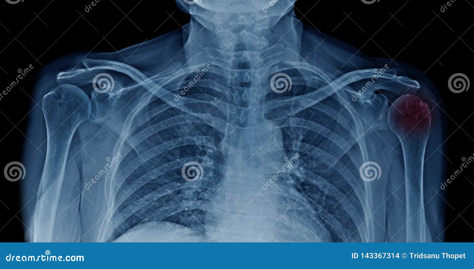 X-ray Of The Head Of The Humerus Of A Dog With Bone Cancer ...