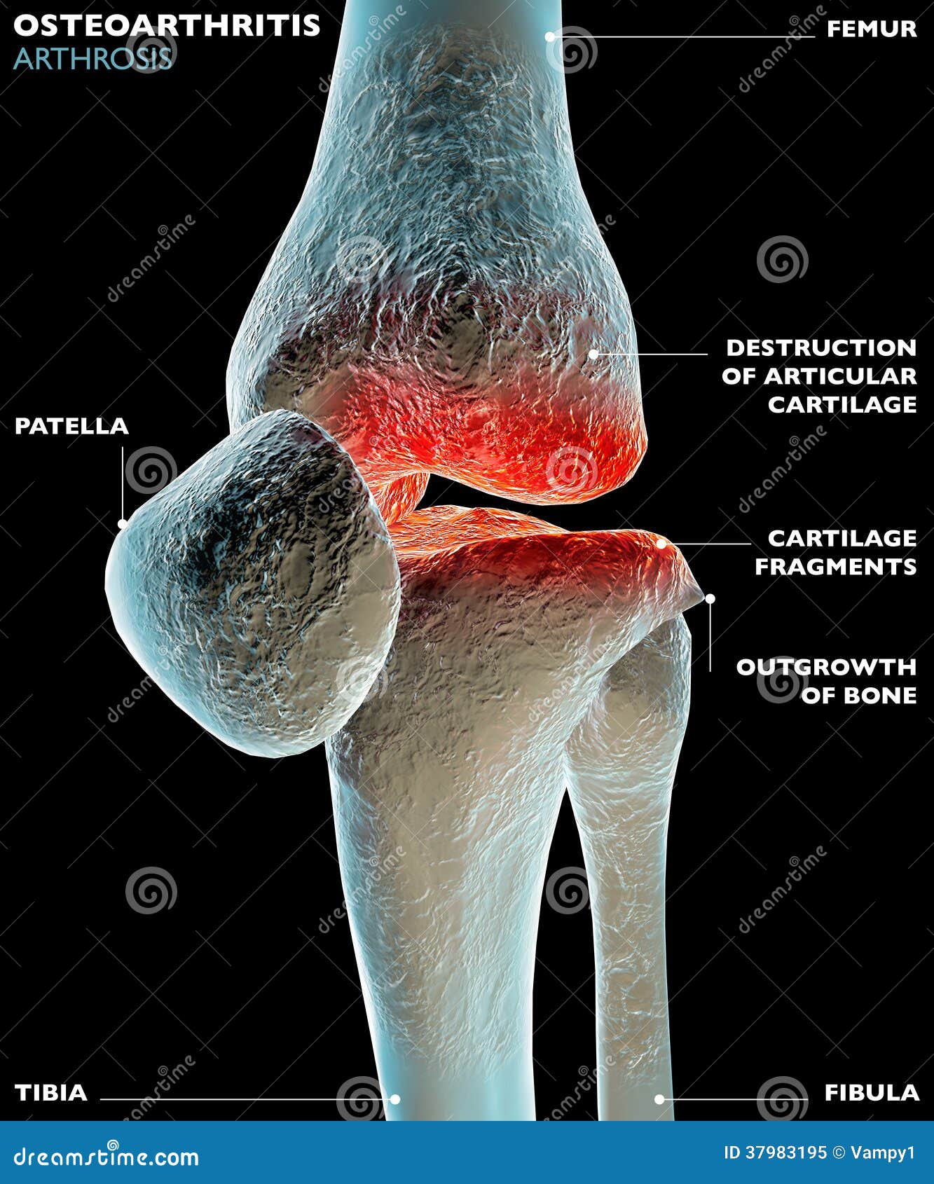 Knee Disease Color Button Icon. Total Knee Replacement Surgery. Vector ...