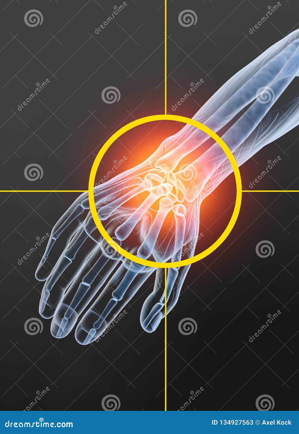 Osteoarthritis, Painful Wrist Joint, 3D Illustration 2 Stock ...
