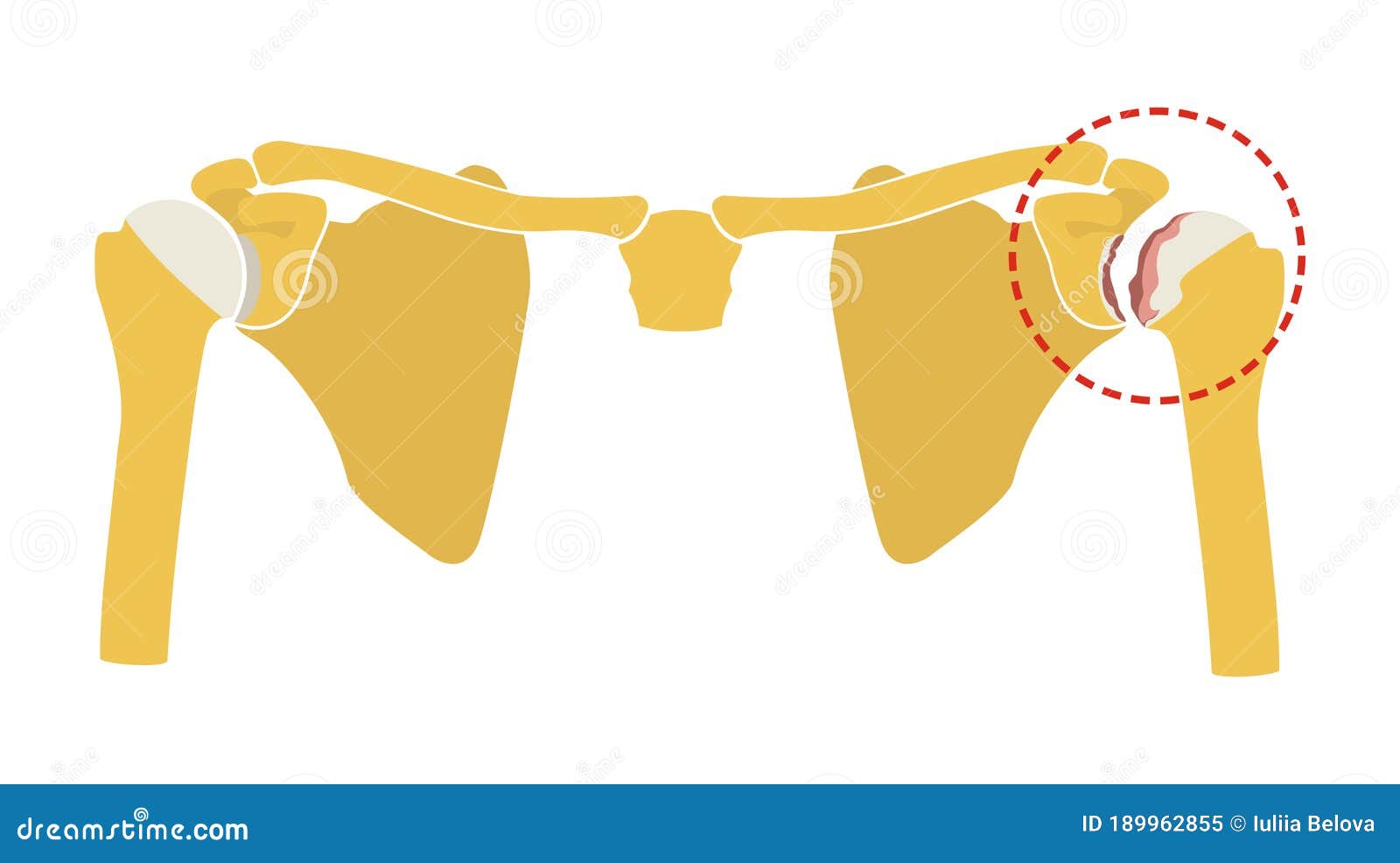 Cartilage Vector Illustration. Scheme Of Chondrocytes, Collagen Fibers ...